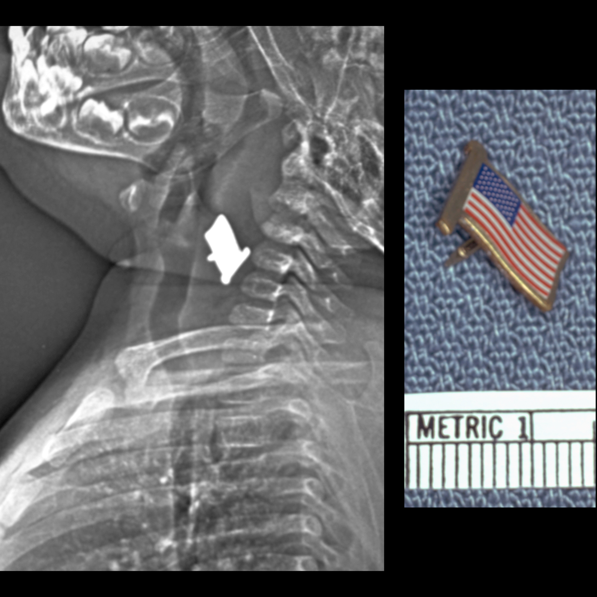 Pediatric Gastrointestinal Foreign Body | Pediatric Radiology Reference ...