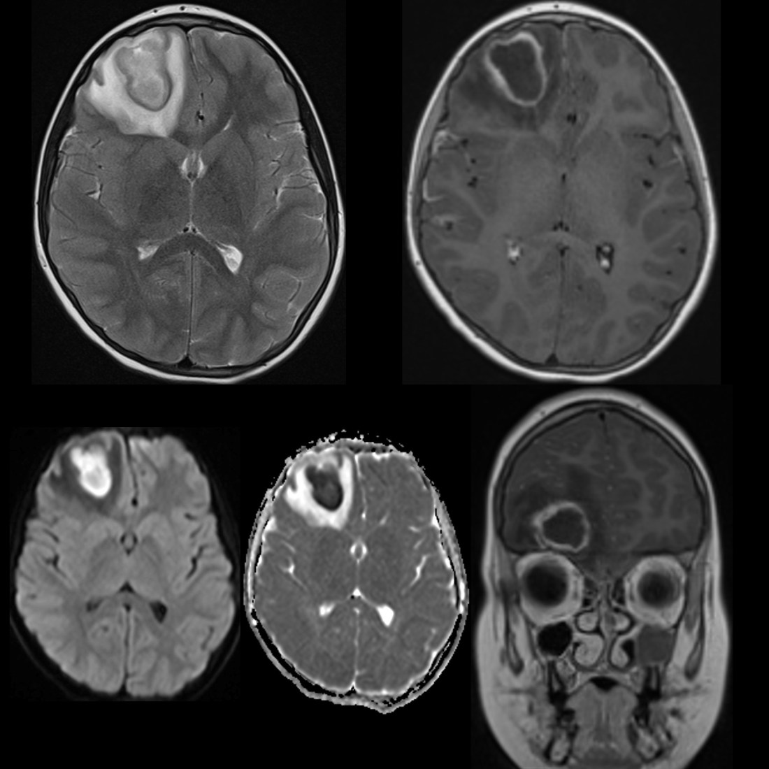 Pediatric Cerebritis and Pediatric Cerebral Abscess | Pediatric ...