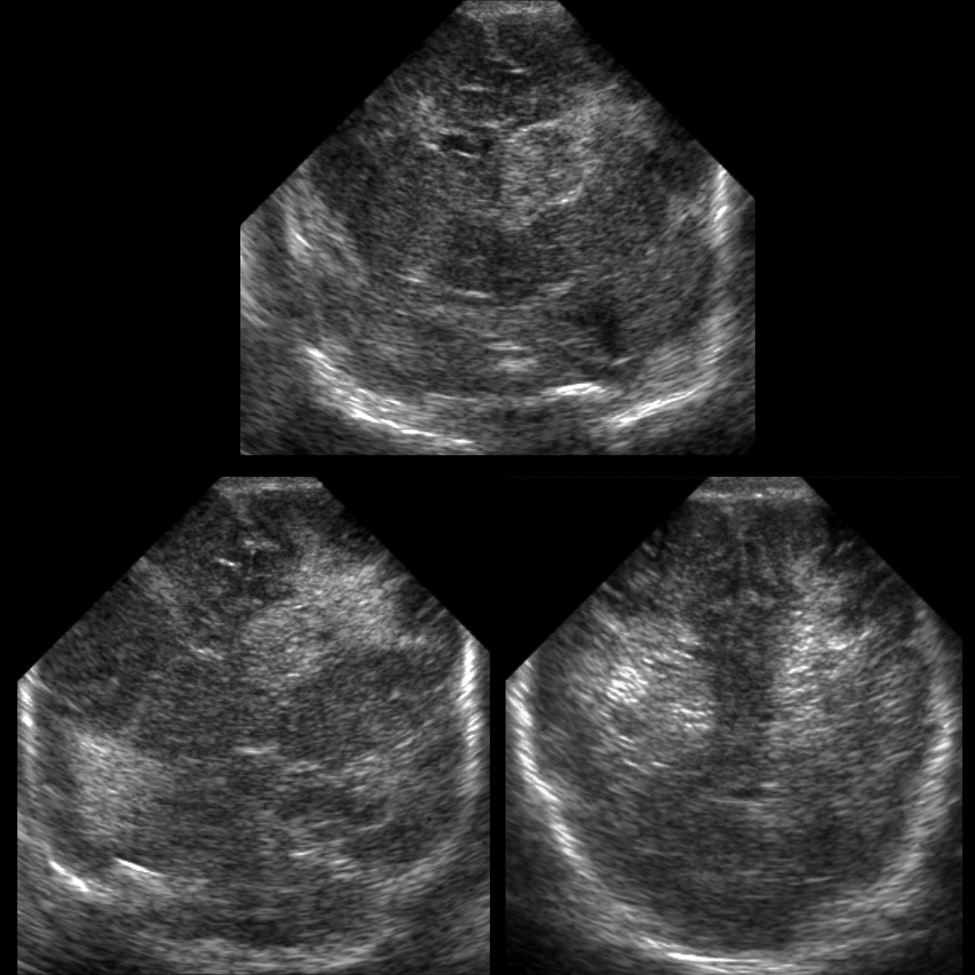 Periventricular Hemorrhagic Infarct | Pediatric Radiology Reference ...