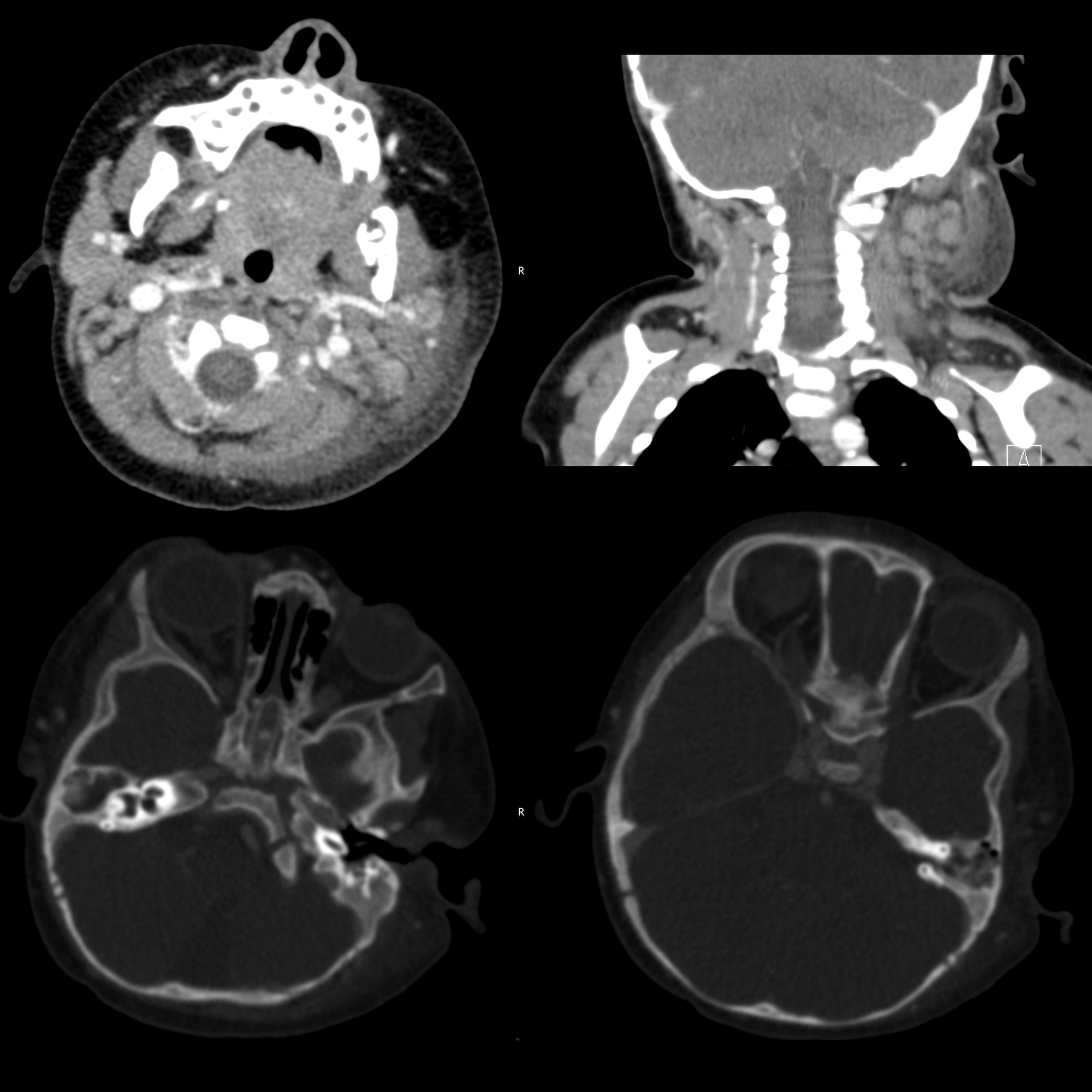 Pediatric Acute Mastoiditis | Pediatric Radiology Reference Article ...