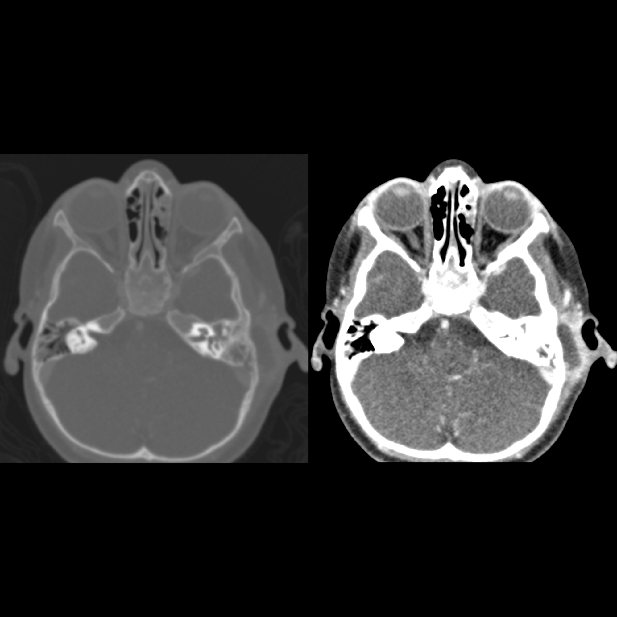 Pediatric Acute Mastoiditis | Pediatric Radiology Reference Article ...