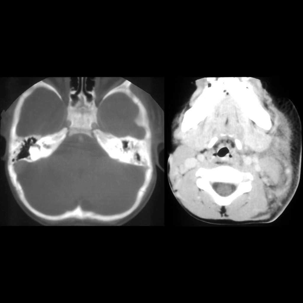 Pediatric Acute Mastoiditis | Pediatric Radiology Reference Article ...