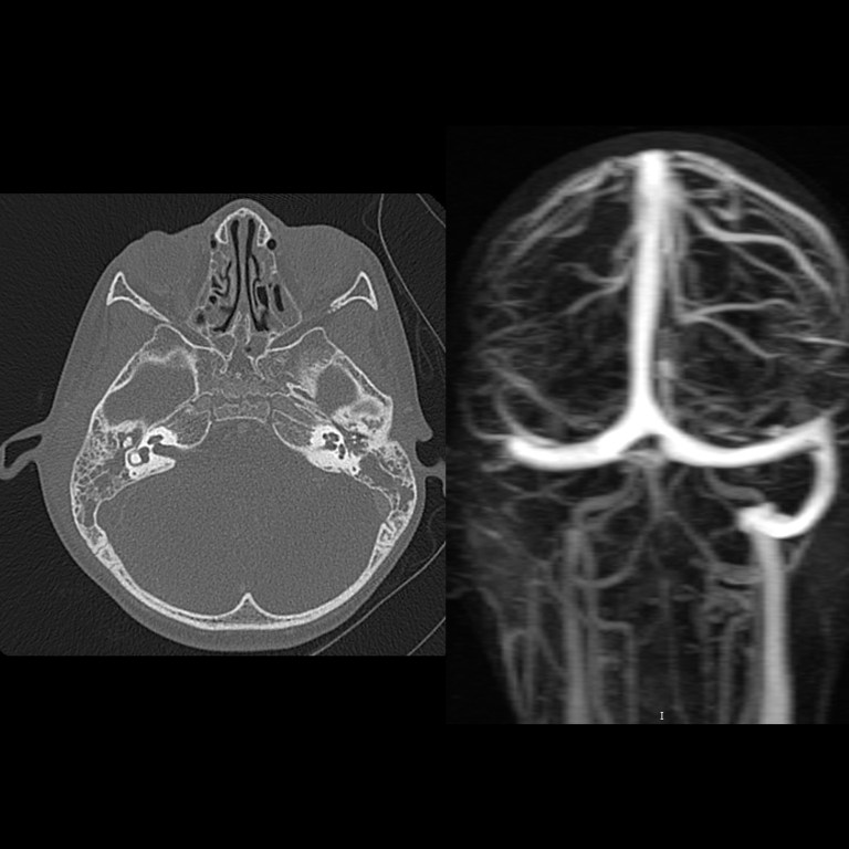 Pediatric Acute Mastoiditis | Pediatric Radiology Reference Article ...