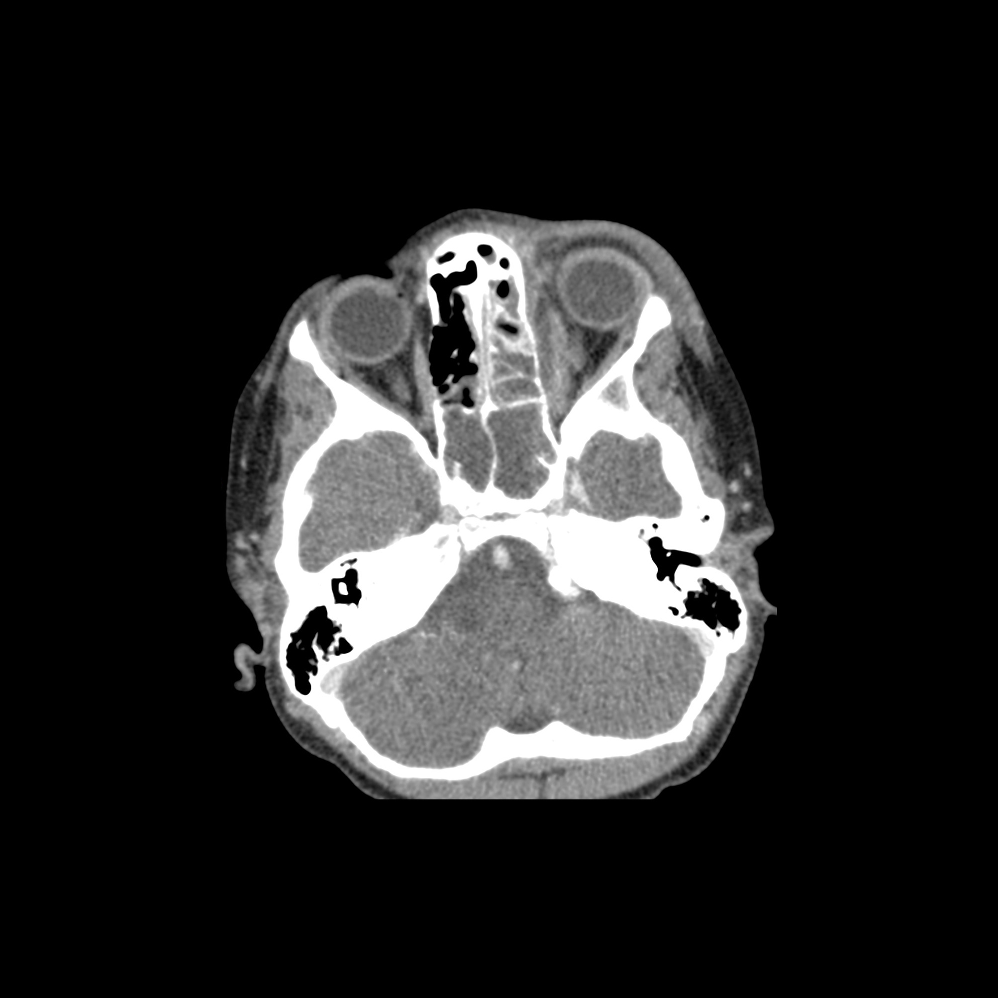 Pediatric Sinusitis | Pediatric Radiology Reference Article | Pediatric ...