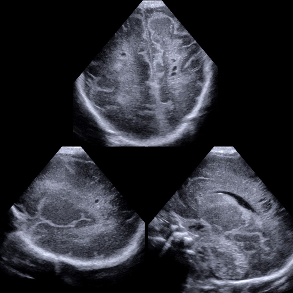 Periventricular Leukomalacia | Pediatric Radiology Reference Article ...