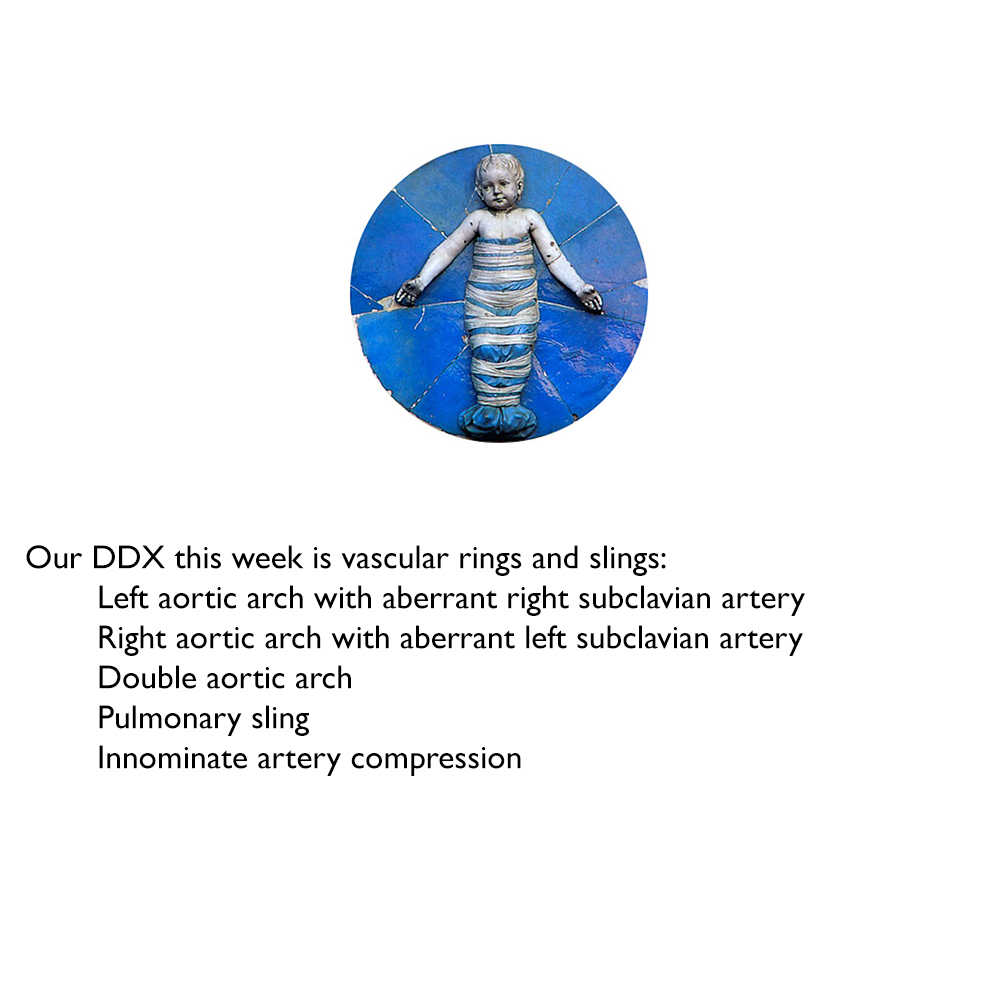 PIDDXVascularRings | Pediatric Radiology Case | Pediatric Imaging ...