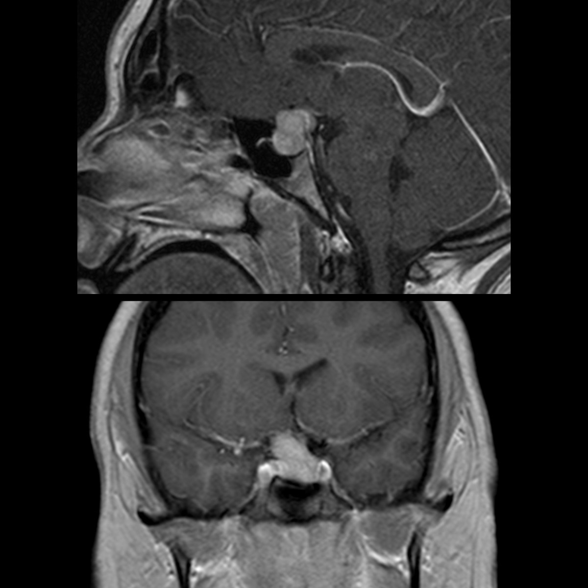 Teenager with short stature | Pediatric Radiology Case | Pediatric ...