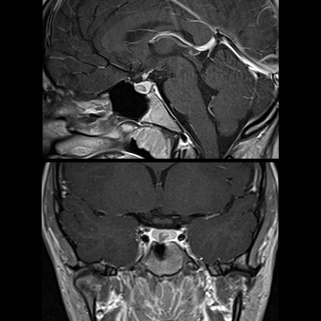 Pediatric Pituitary Microadenoma | Pediatric Radiology Reference ...