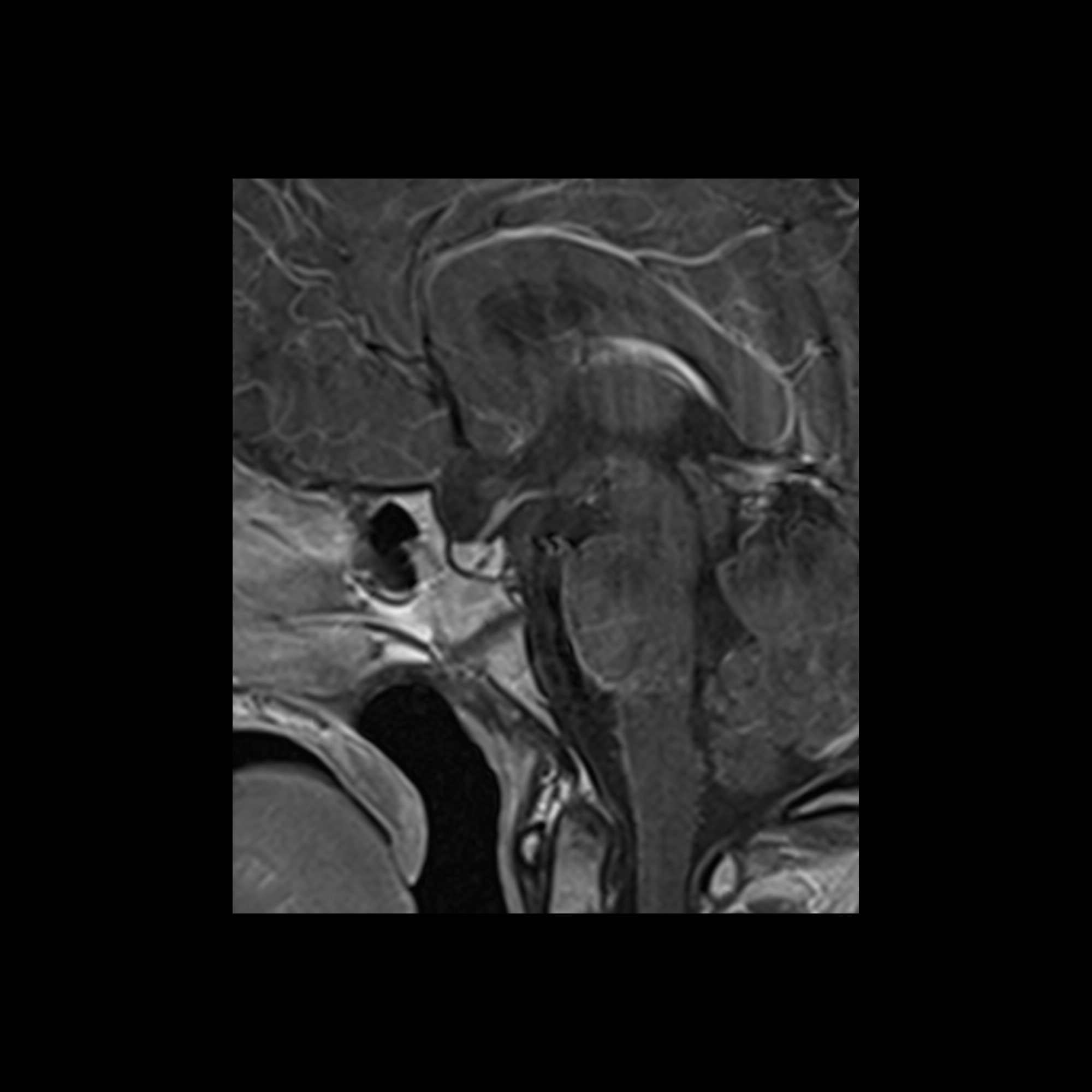 Pediatric Rathke Cleft Cyst | Pediatric Radiology Reference Article ...