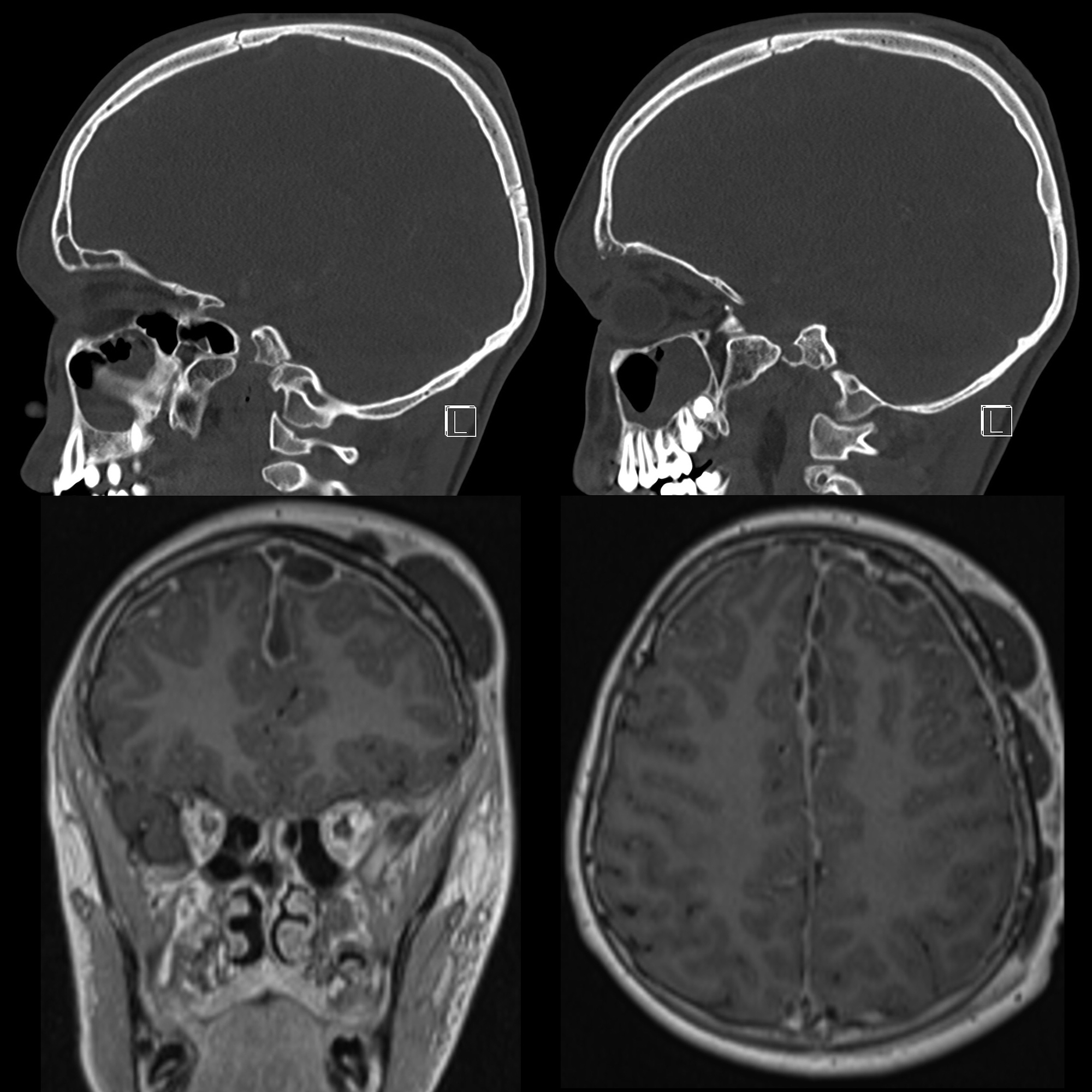 Pediatric Subdural Empyema and Epidural Empyema | Pediatric Radiology ...