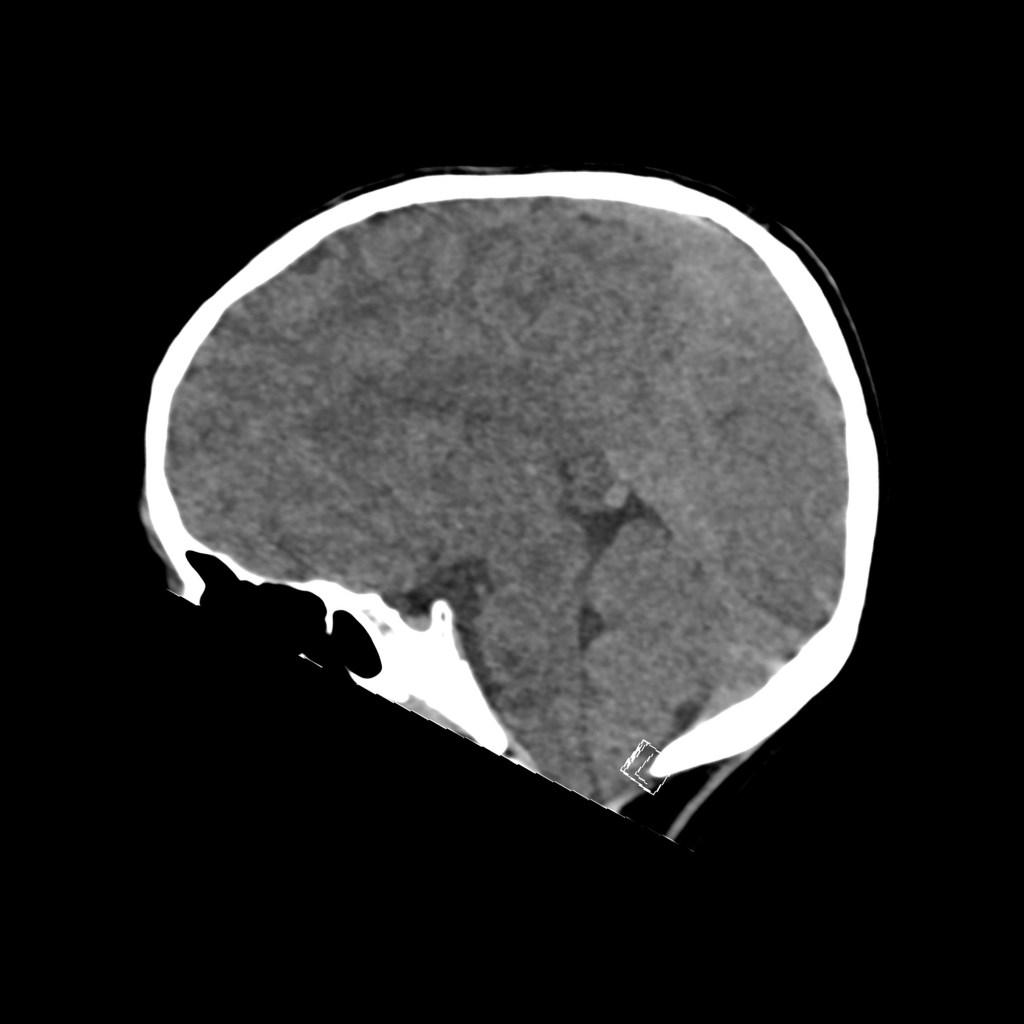Chiari I Malformation | Pediatric Radiology Reference Article ...