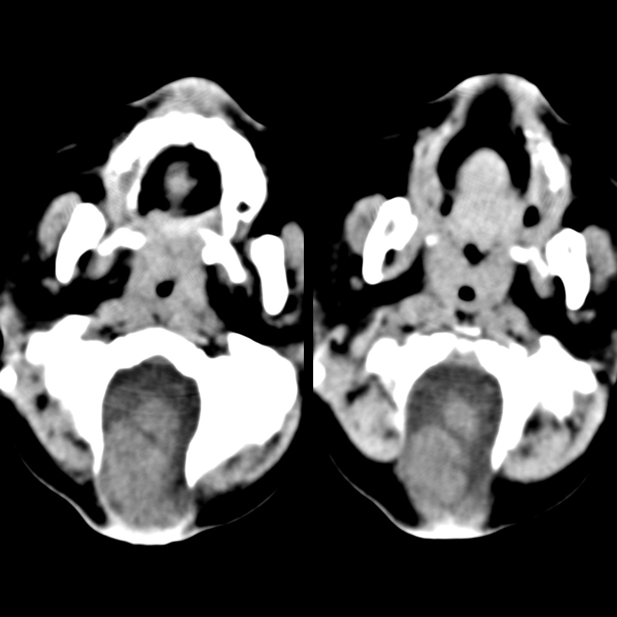 Newborn with an abnormal bump in the posterior midline at the skull ...