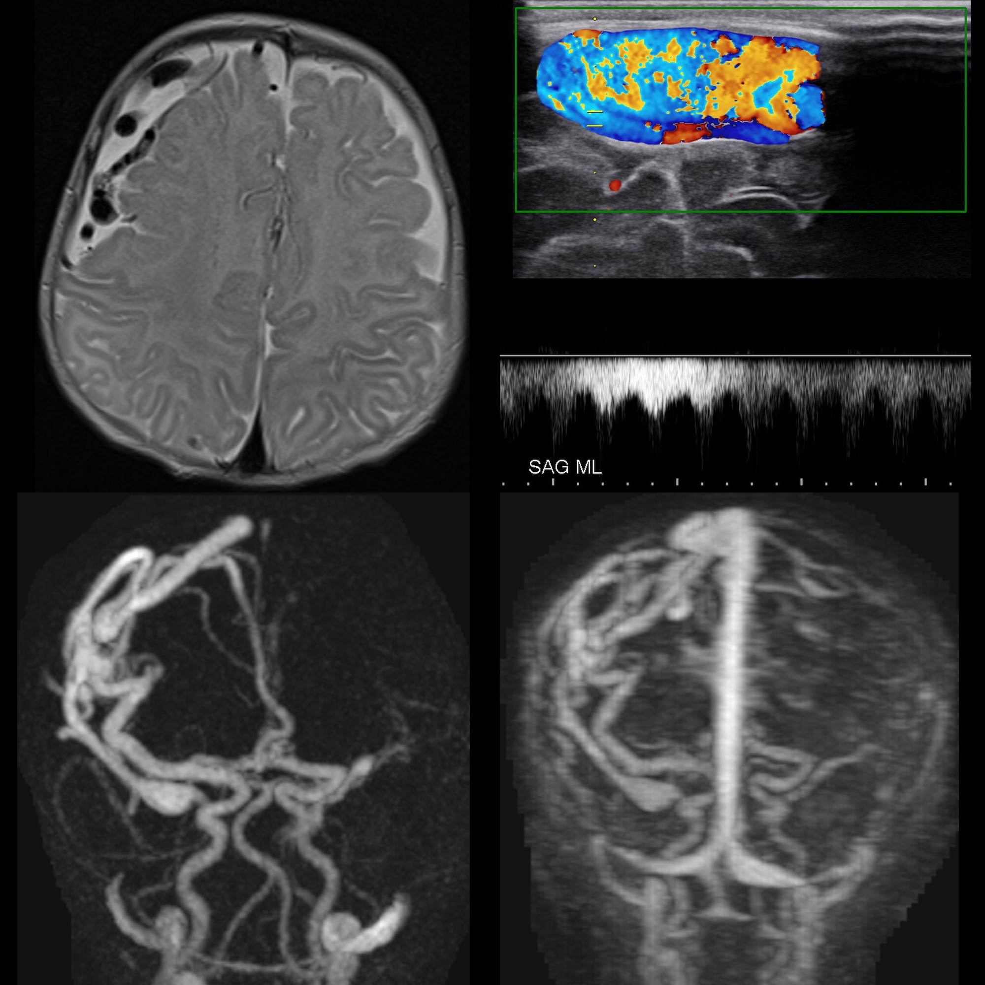 Pediatric Intracranial Arteriovenous Malformation | Pediatric Radiology ...