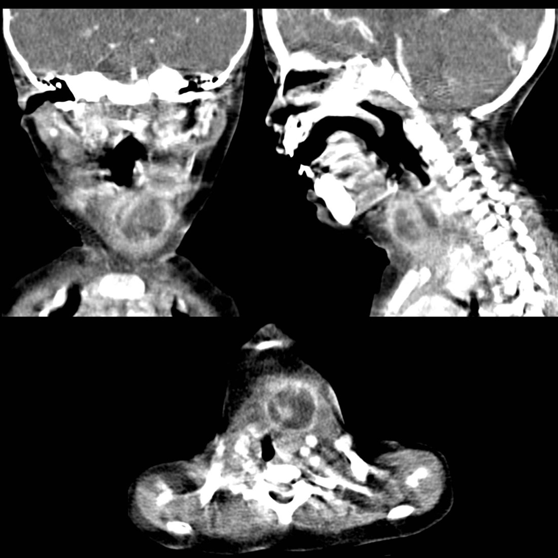 Fourth Branchial Cleft Cyst | Pediatric Radiology Reference Article ...