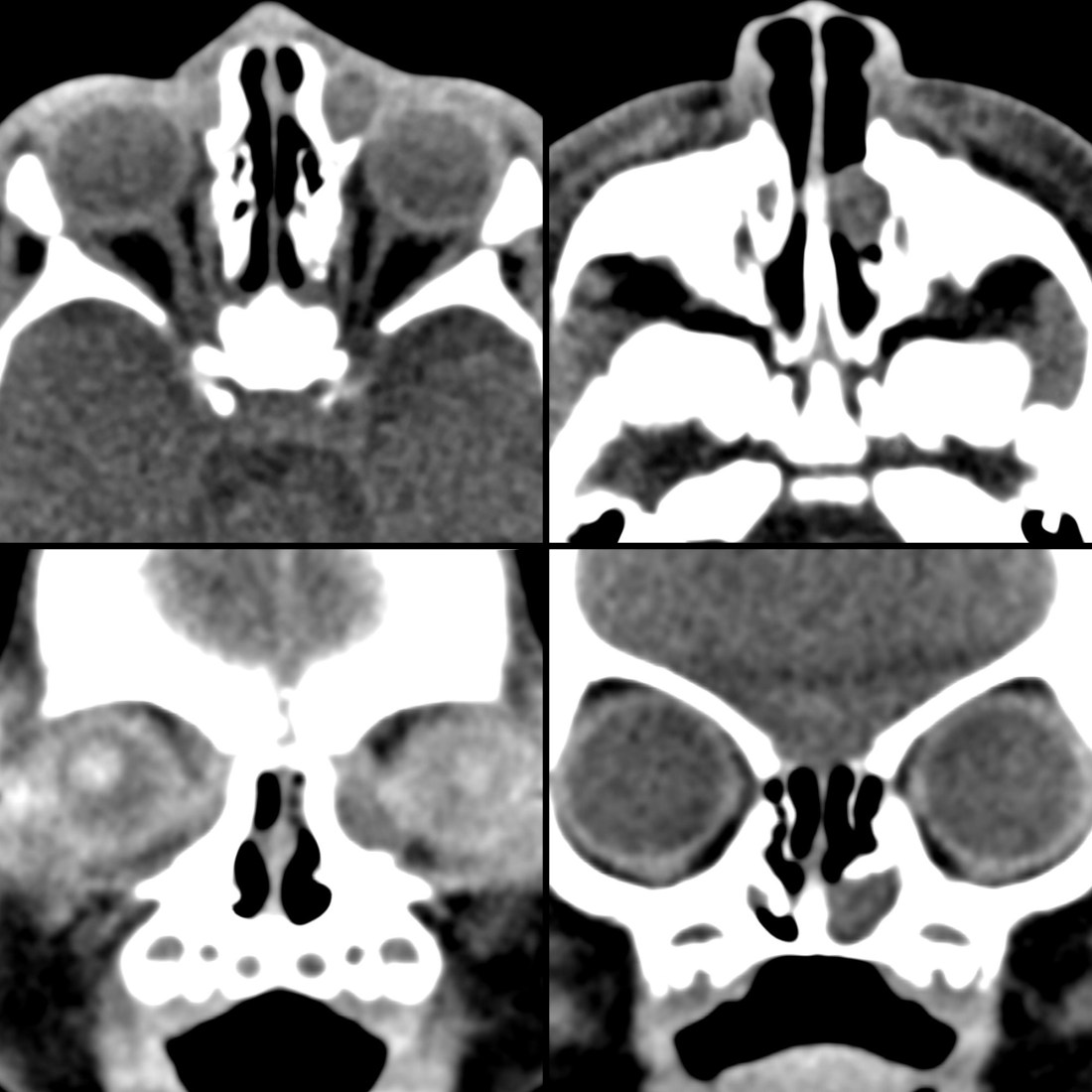 Dacrocystocele | Pediatric Radiology Reference Article | Pediatric ...