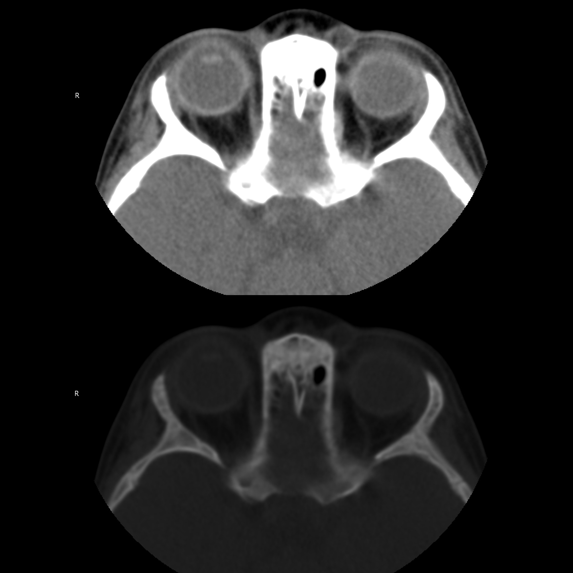 Pediatric Dermoid | Pediatric Radiology Reference Article | Pediatric ...