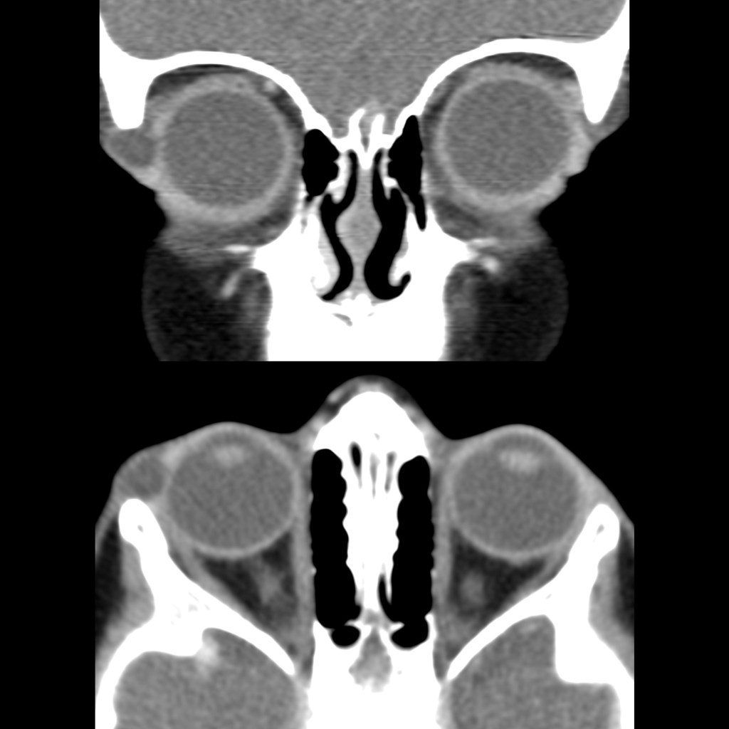 Pediatric Dermoid | Pediatric Radiology Reference Article | Pediatric ...