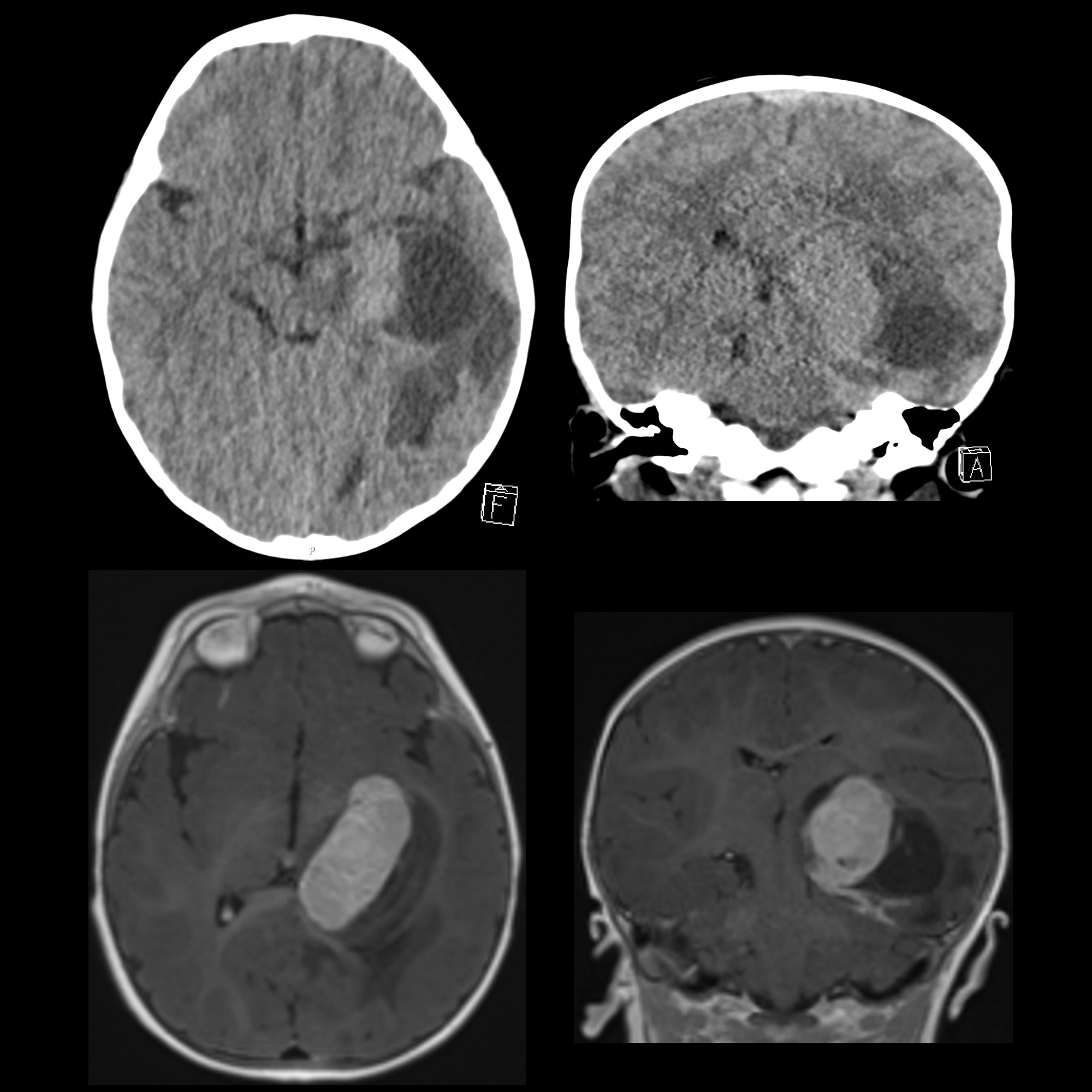 Desmoplastic Infantile Ganglioglioma | Pediatric Radiology Reference ...