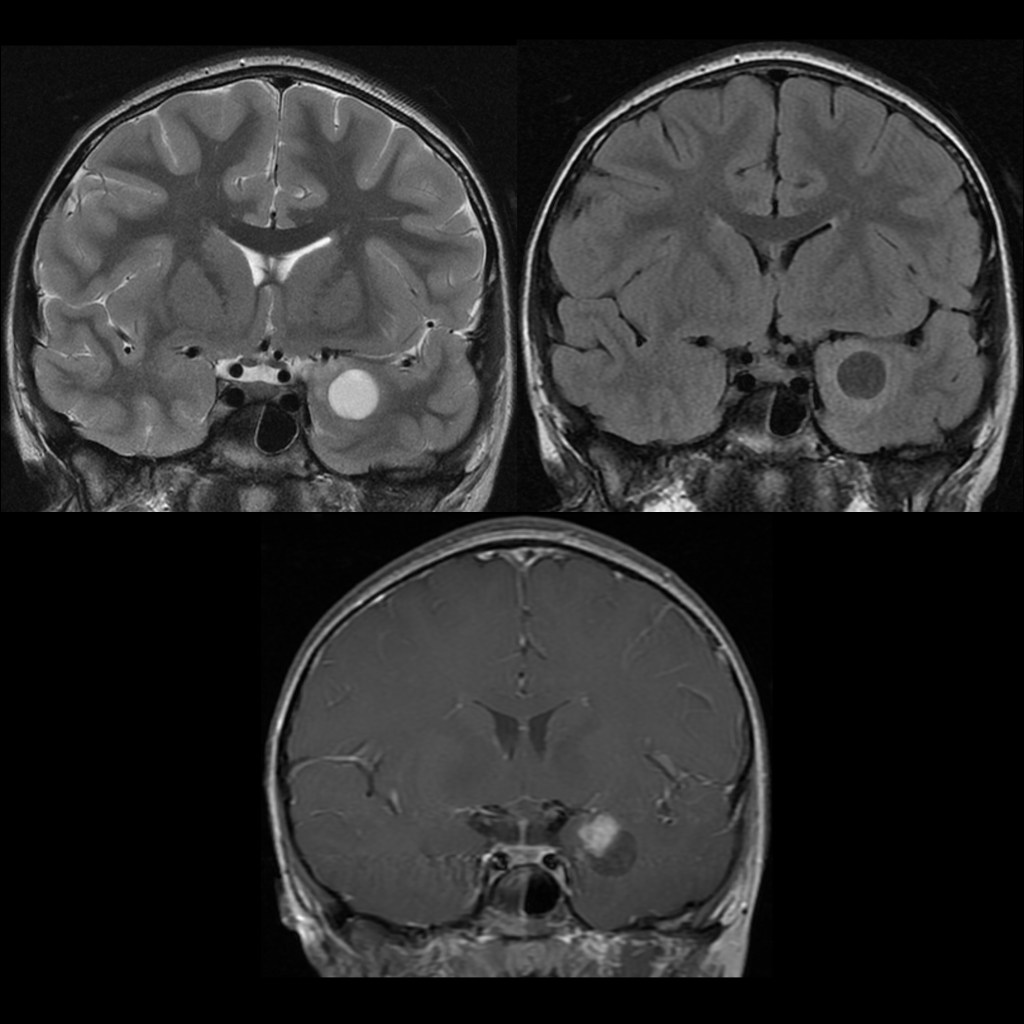 Pediatric Ganglioglioma | Pediatric Radiology Reference Article ...