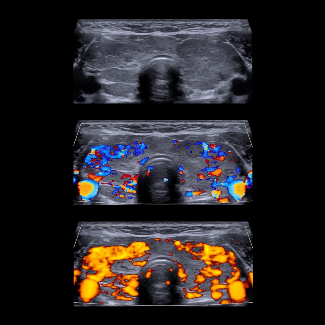 Pediatric Graves Disease | Pediatric Radiology Reference Article ...