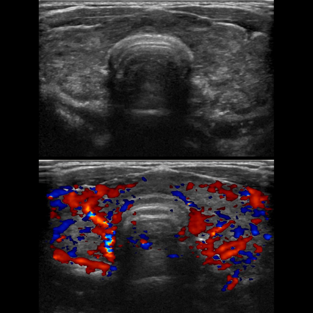 Hashimoto Thyroiditis | Pediatric Radiology Reference Article ...