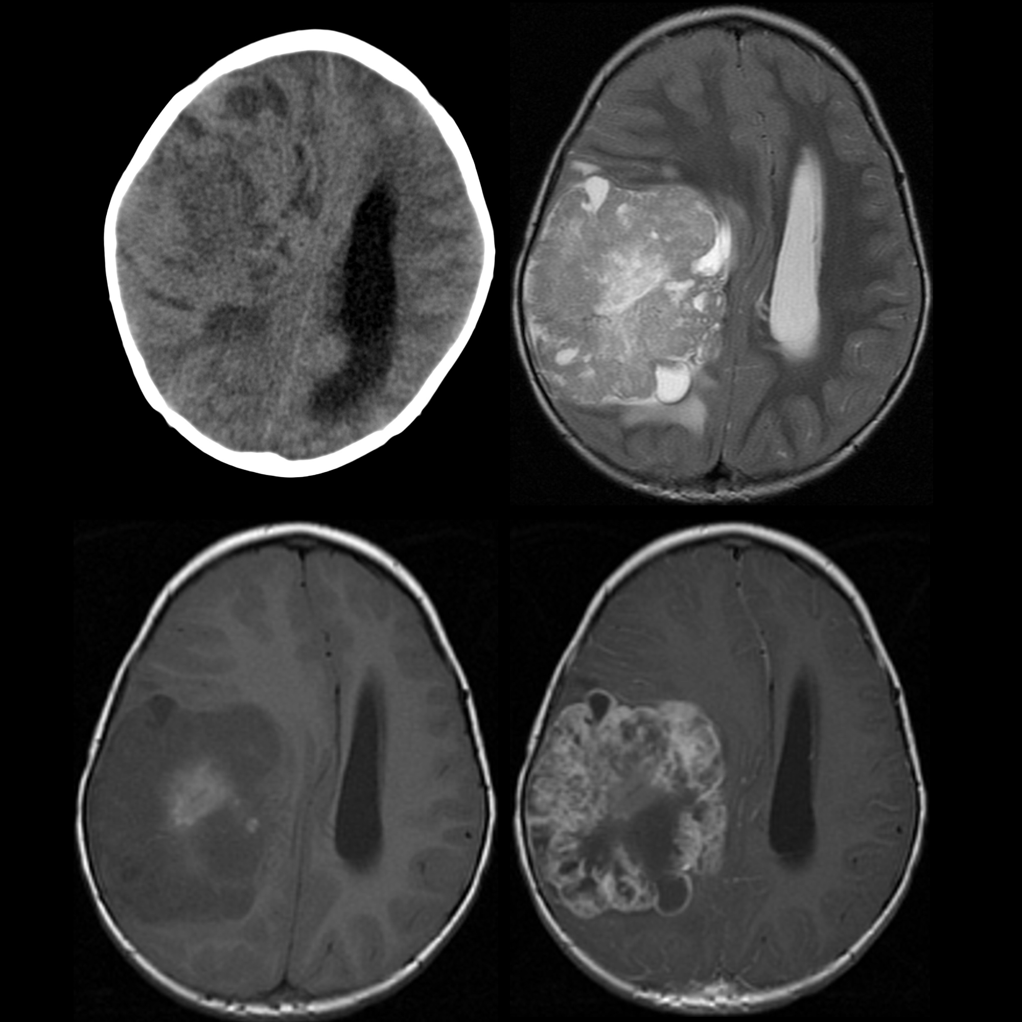 Pediatric Supratentorial Primitive Neuroectodermal Tumor | Pediatric ...