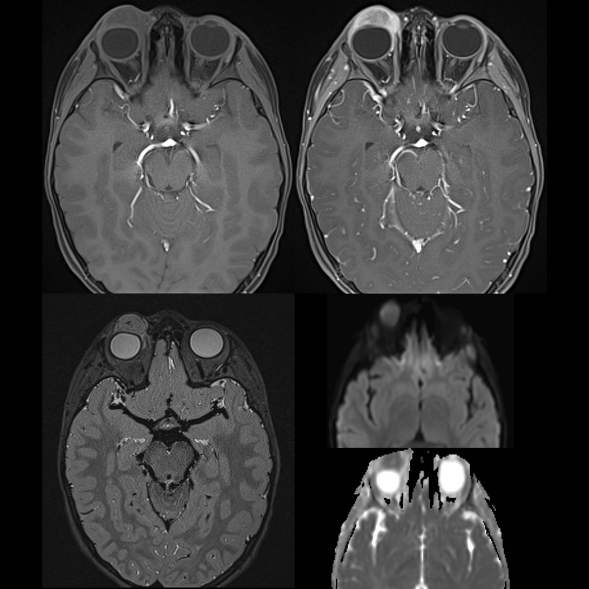 Preschooler with 2 weeks of right eye swelling | Pediatric Radiology ...