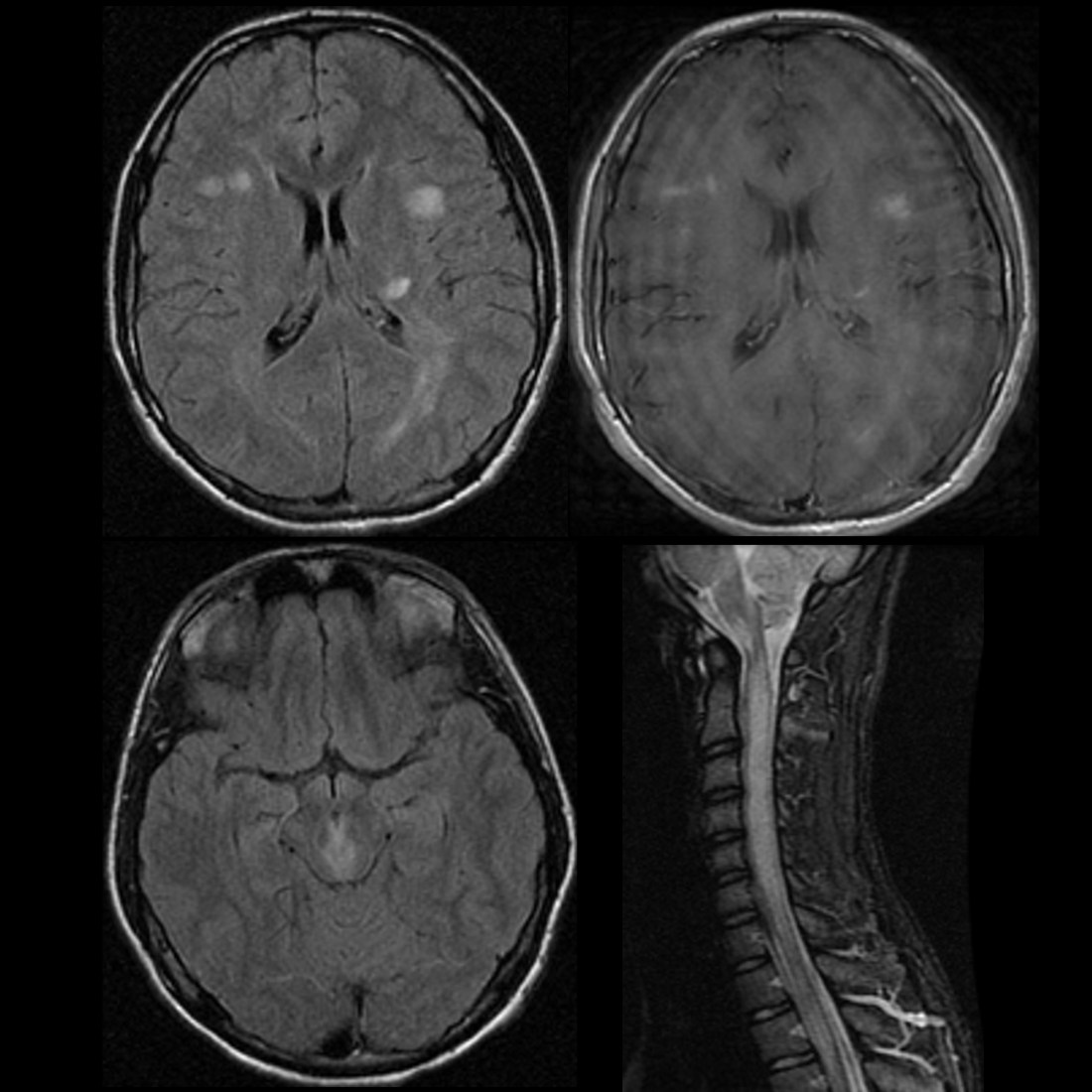 Acute Disseminated Encephalomyelitis | Pediatric Radiology Reference ...