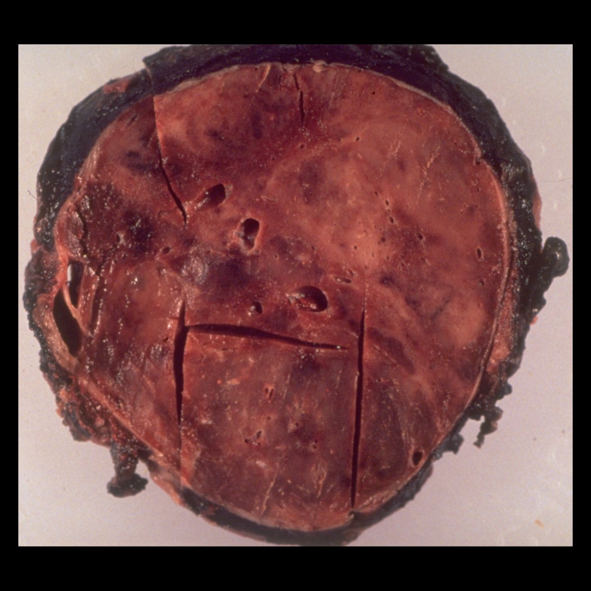 Female teenager with hirsuitism and virilization and a left adrenal ...