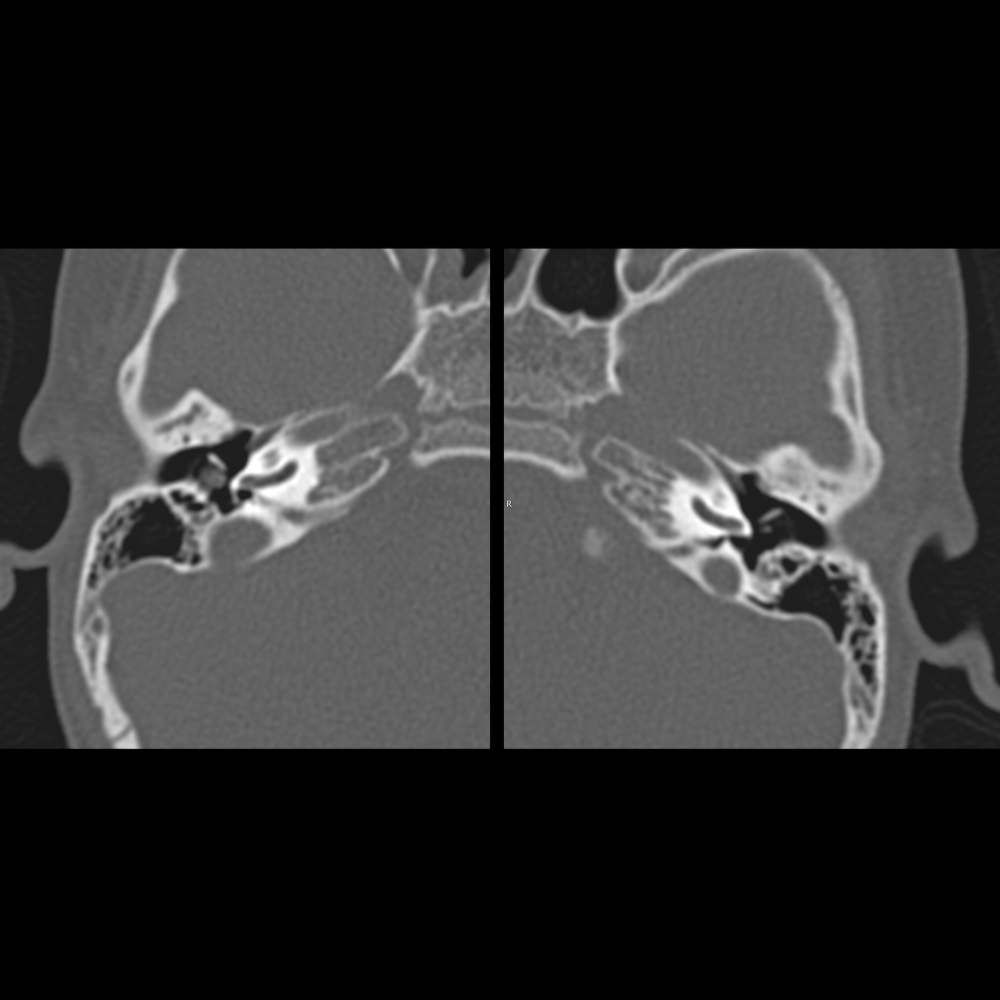 Pediatric Cholesteatoma | Pediatric Radiology Reference Article ...