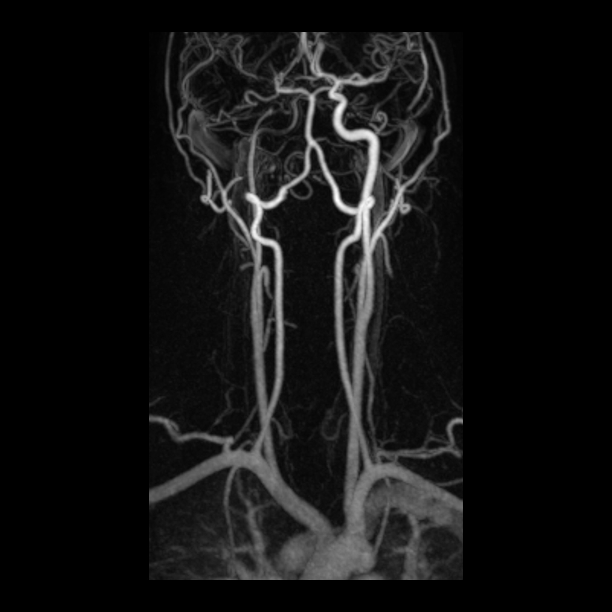 Pediatric Internal Carotid Artery Dissection | Pediatric Radiology ...