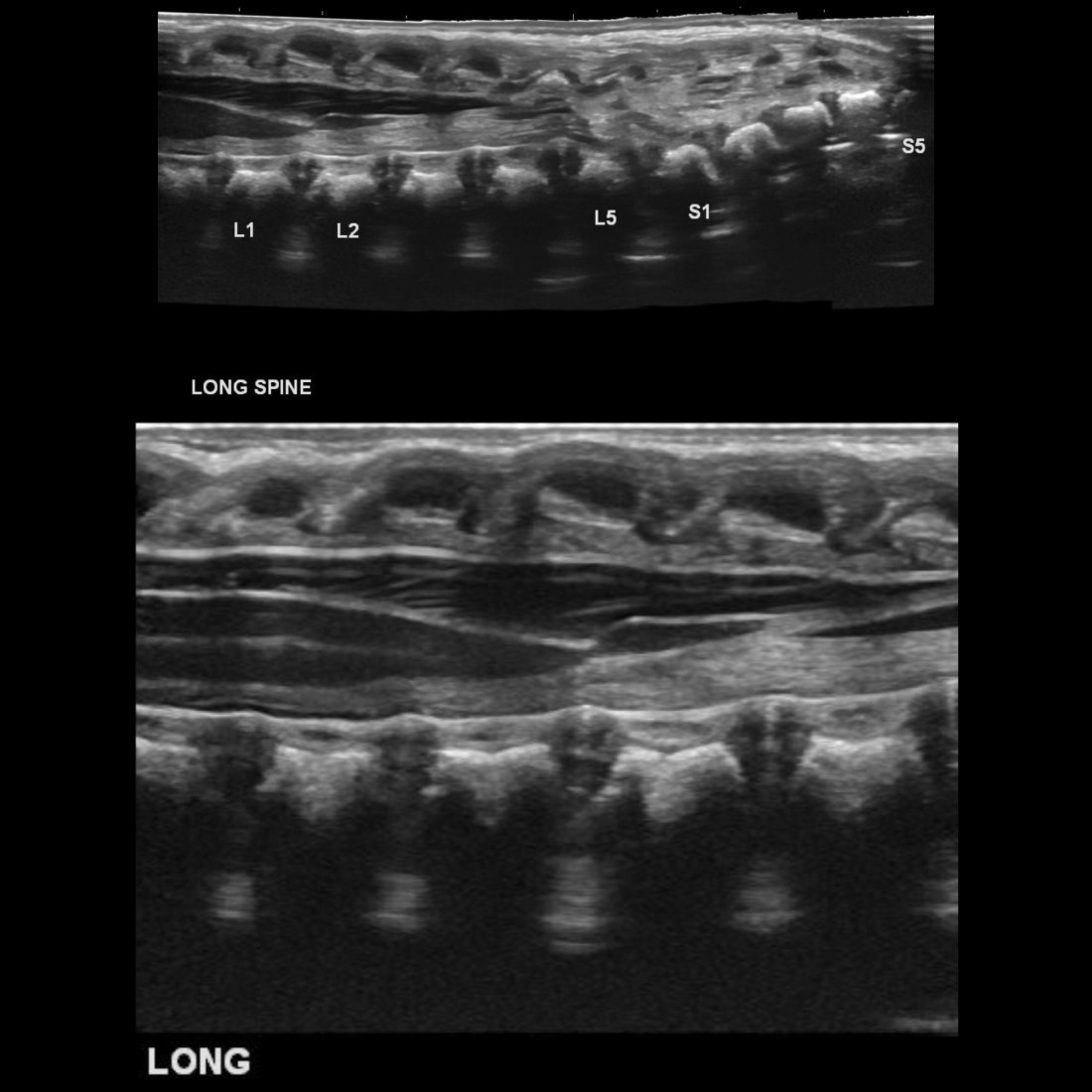 Newborn with a sacral dimple | Pediatric Radiology Case | Pediatric ...