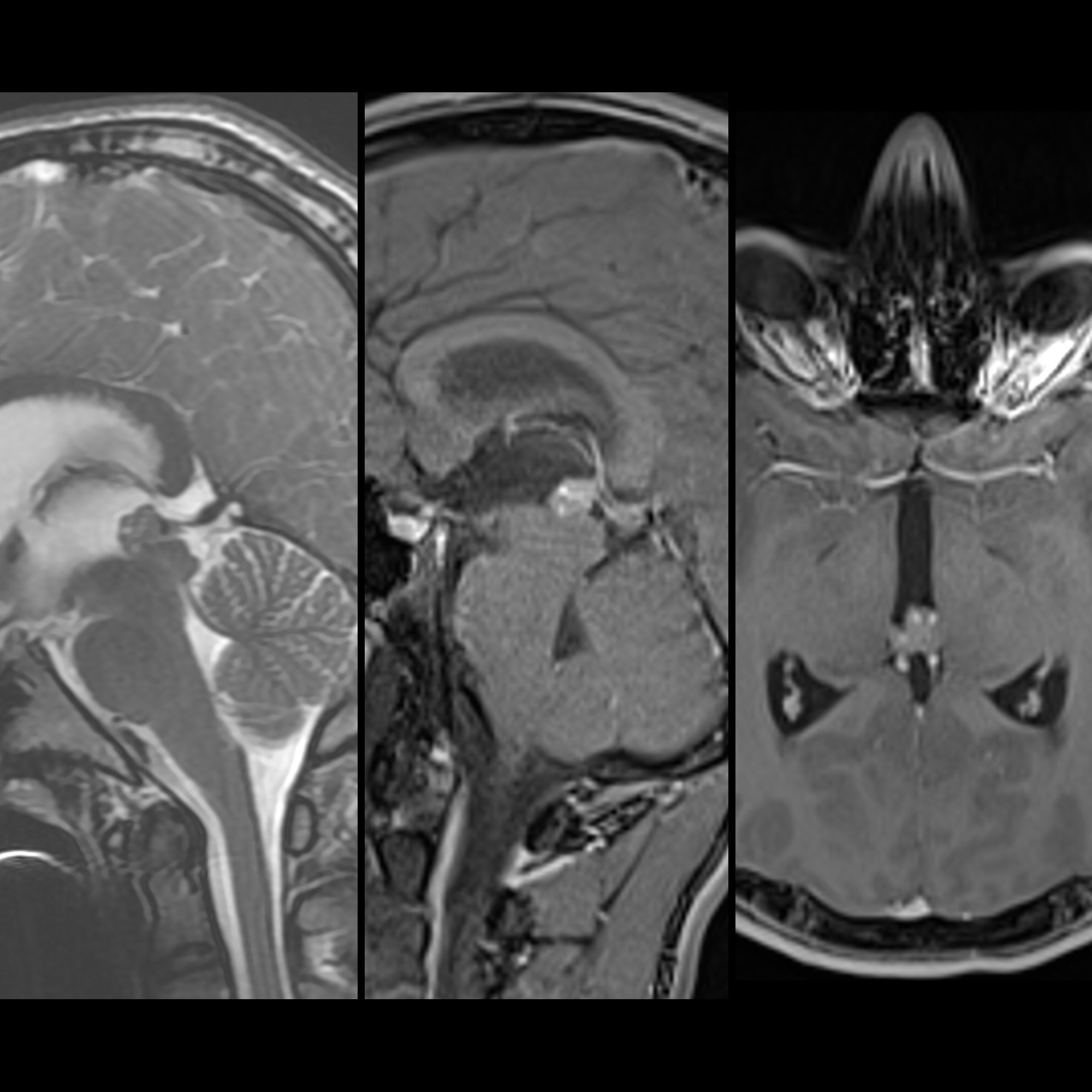 Pediatric Intracranial Germinoma | Pediatric Radiology Reference ...