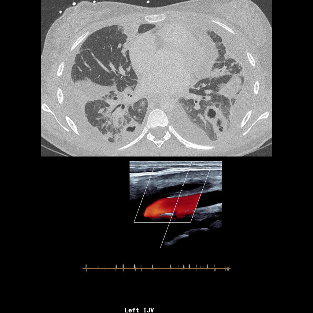 Teenager with pharyngitis and sepsis | Pediatric Radiology Case ...
