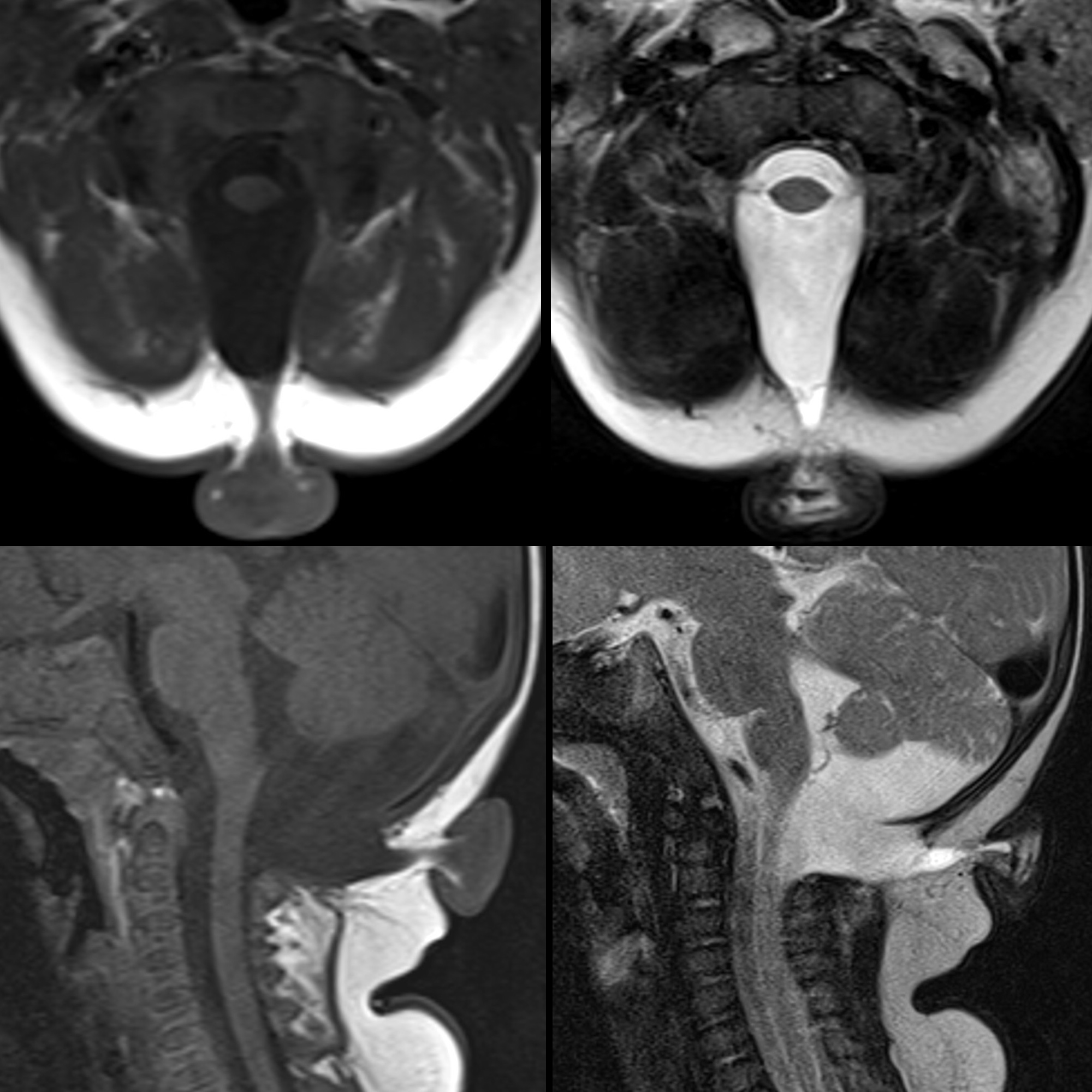 Meningocele | Pediatric Radiology Reference Article | Pediatric Imaging ...