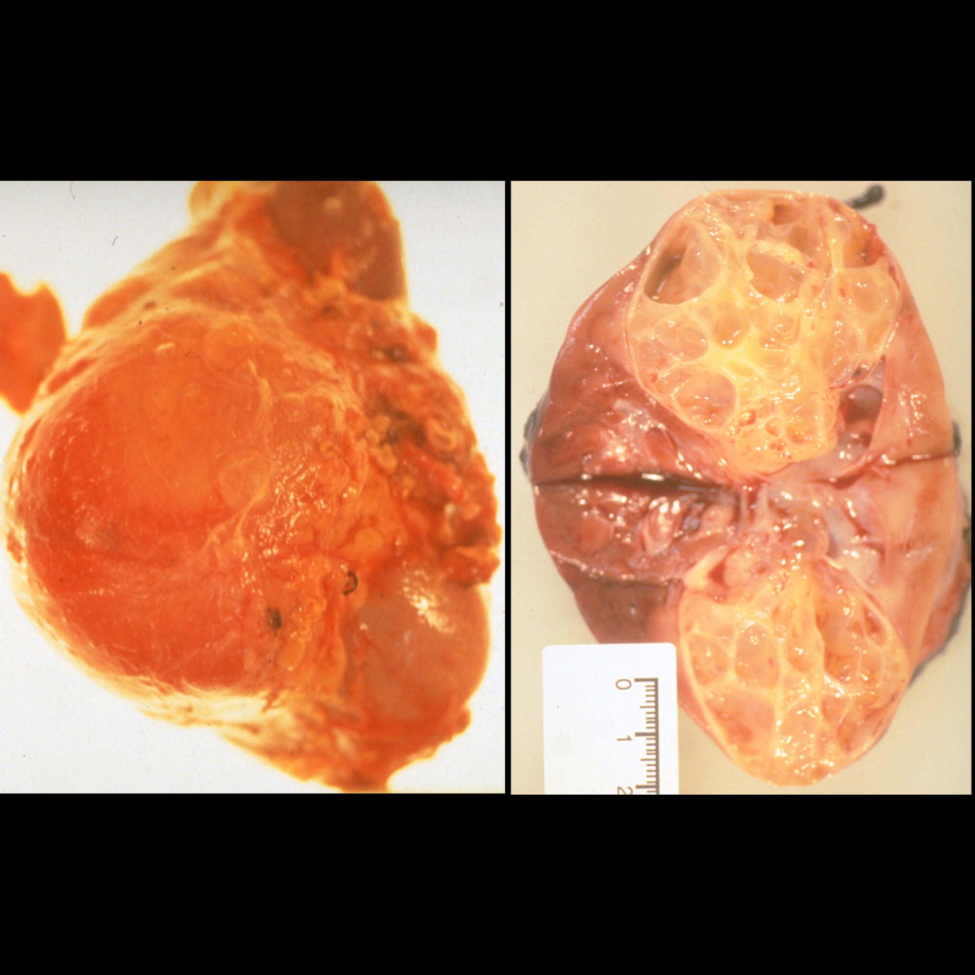 Pediatric Cystic Nephroma | Pediatric Radiology Reference Article ...