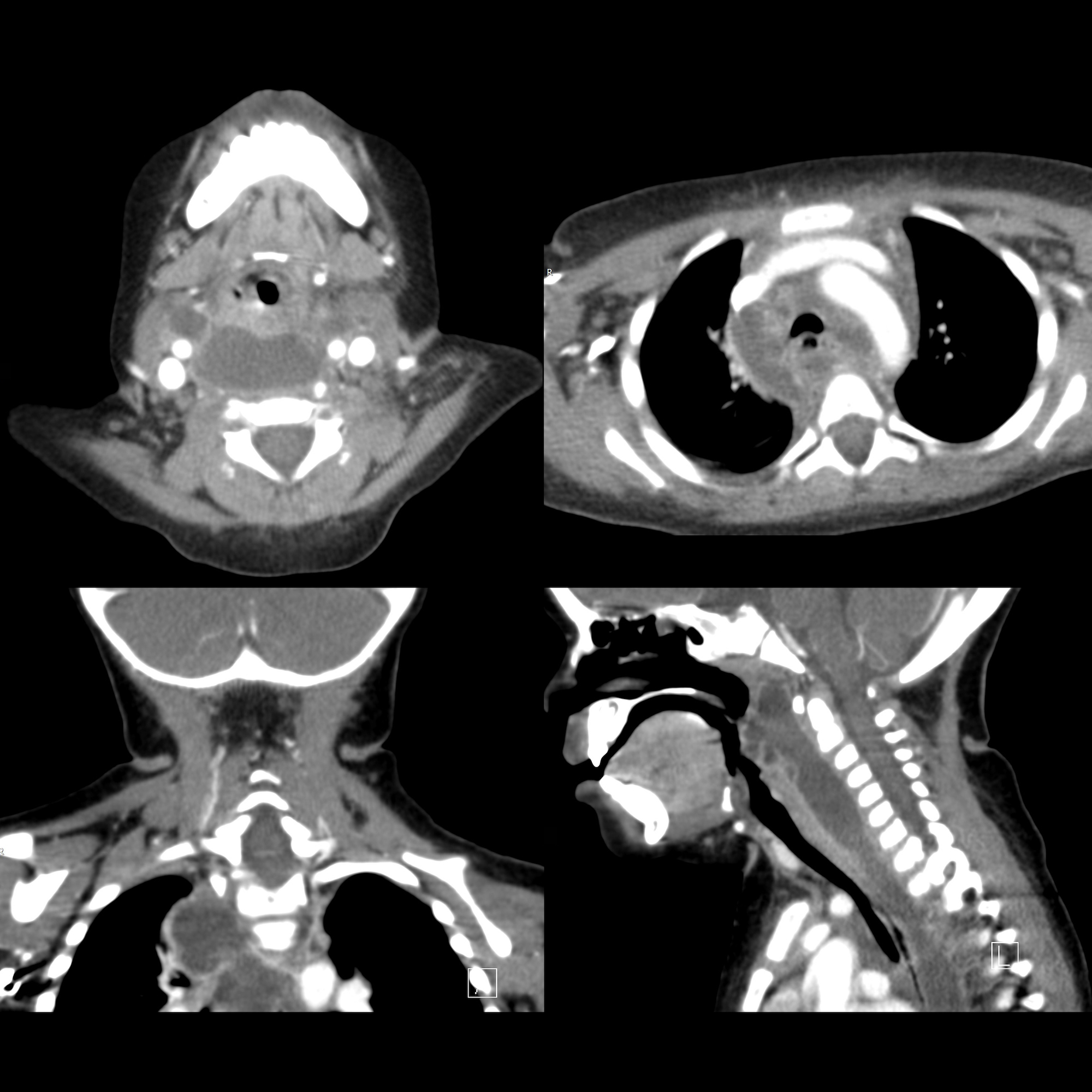 Toddler with fever, dysphagia, and neck pain | Pediatric Radiology Case ...