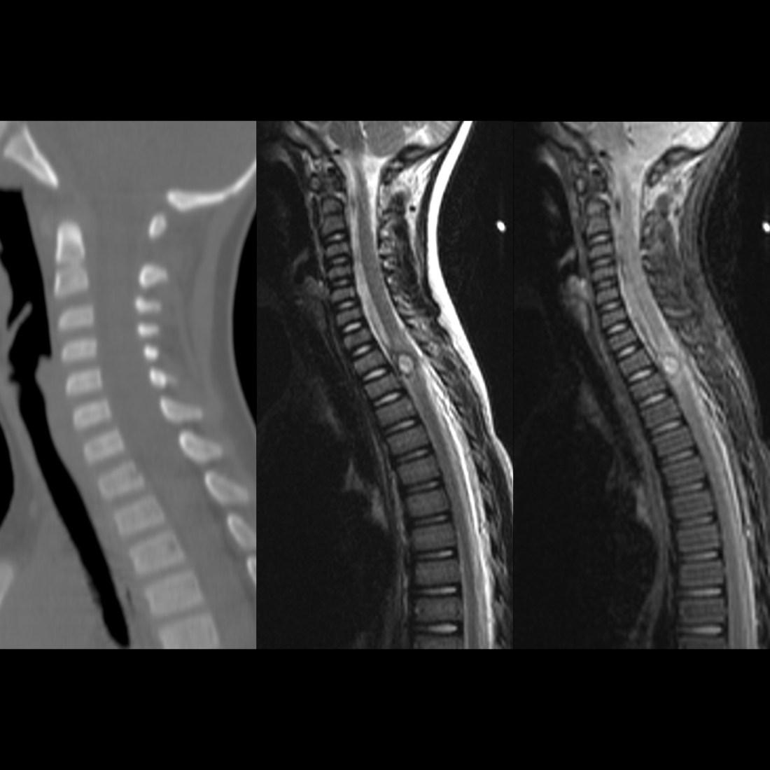 Pediatric Spinal Cord Injury Without Radiological Abnormality ...