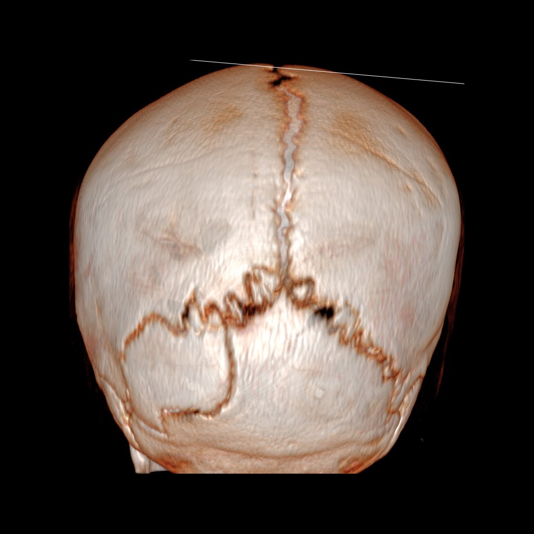 Pediatric Accessory Skull Suture | Pediatric Radiology Reference ...