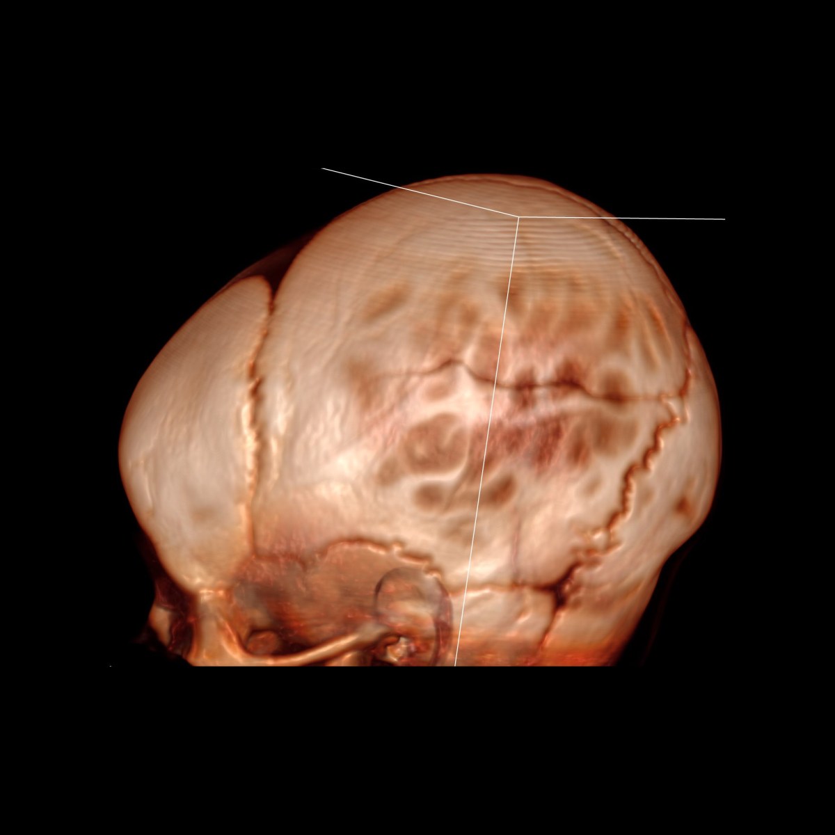 Infant with left parietal soft tissue swelling | Pediatric Radiology ...
