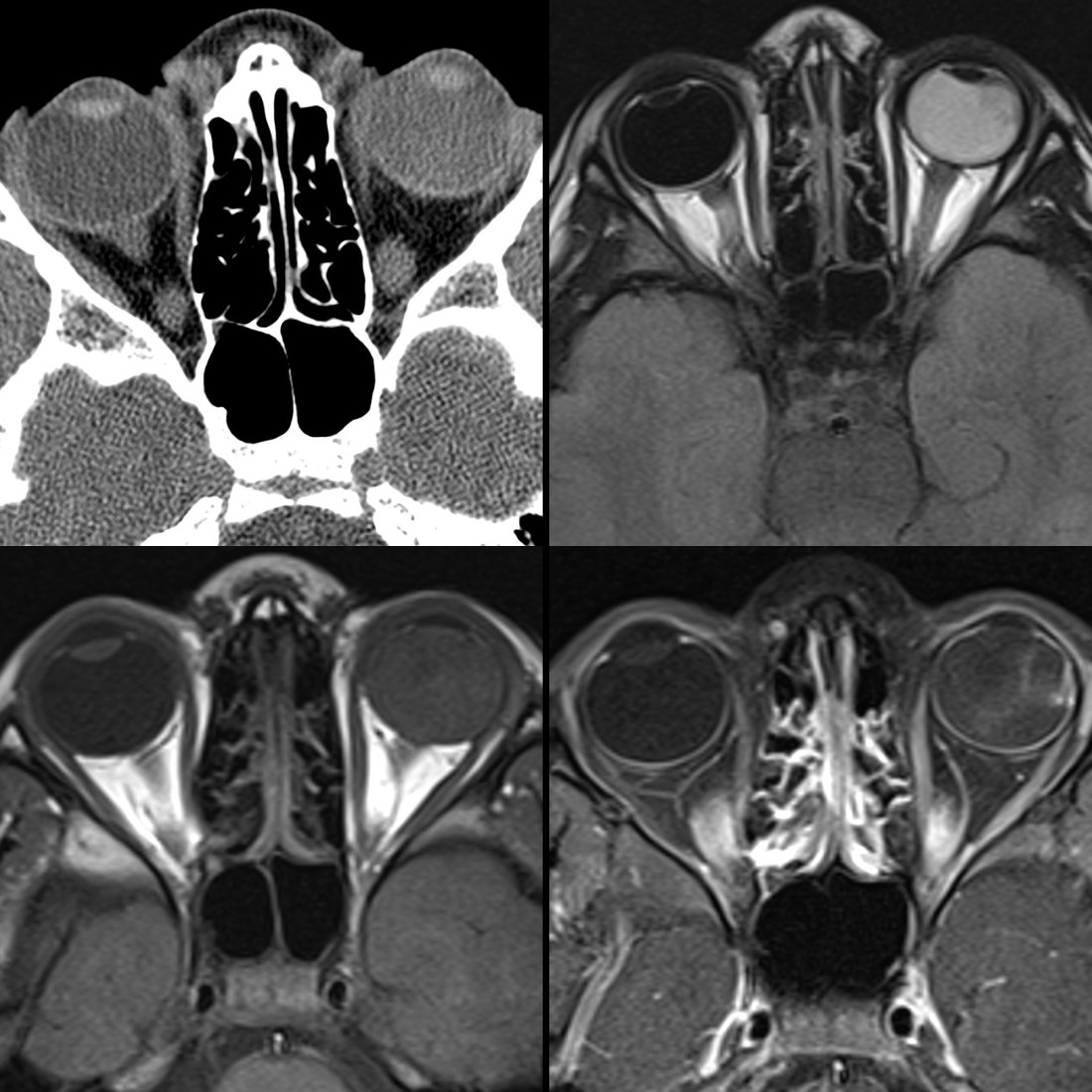 Coat Disease | Pediatric Radiology Reference Article | Pediatric ...