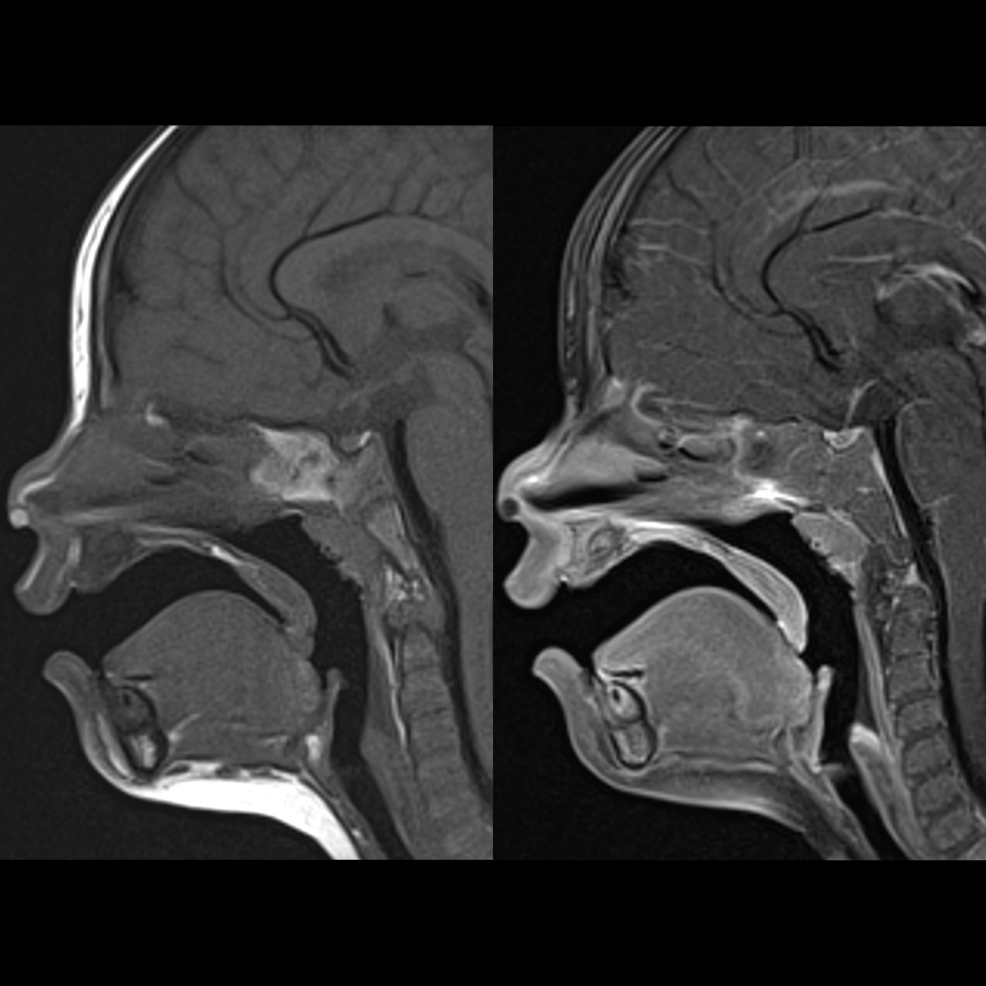 Pediatric Nasal Dermoid | Pediatric Radiology Reference Article ...