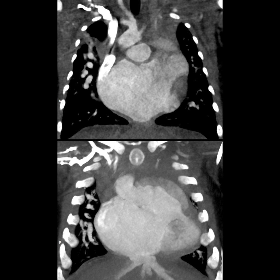 Infant with cyanosis and increased pulmonary blood flow on CXR ...