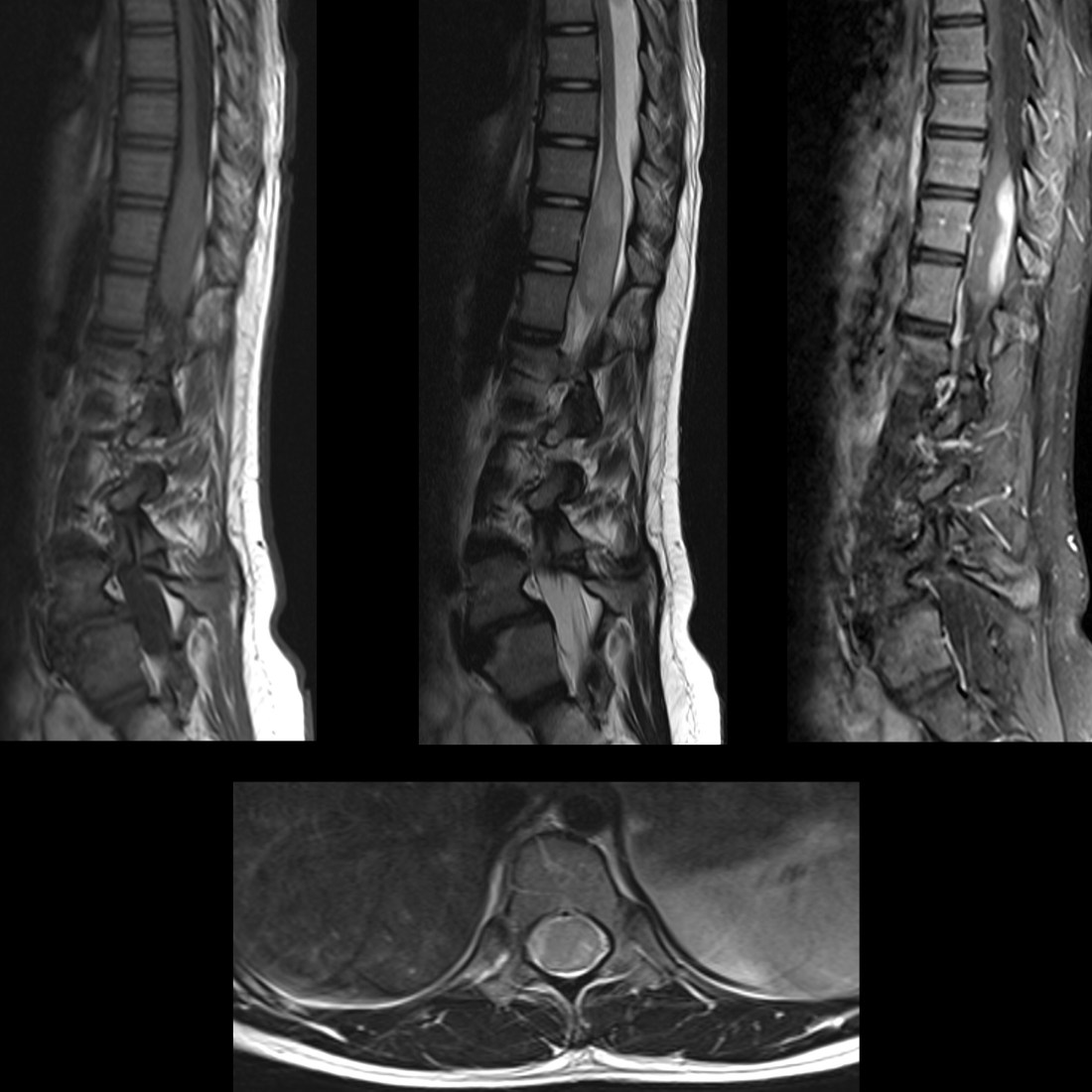 Teenager with back pain and lumbar scoliosis for 1 year | Pediatric ...
