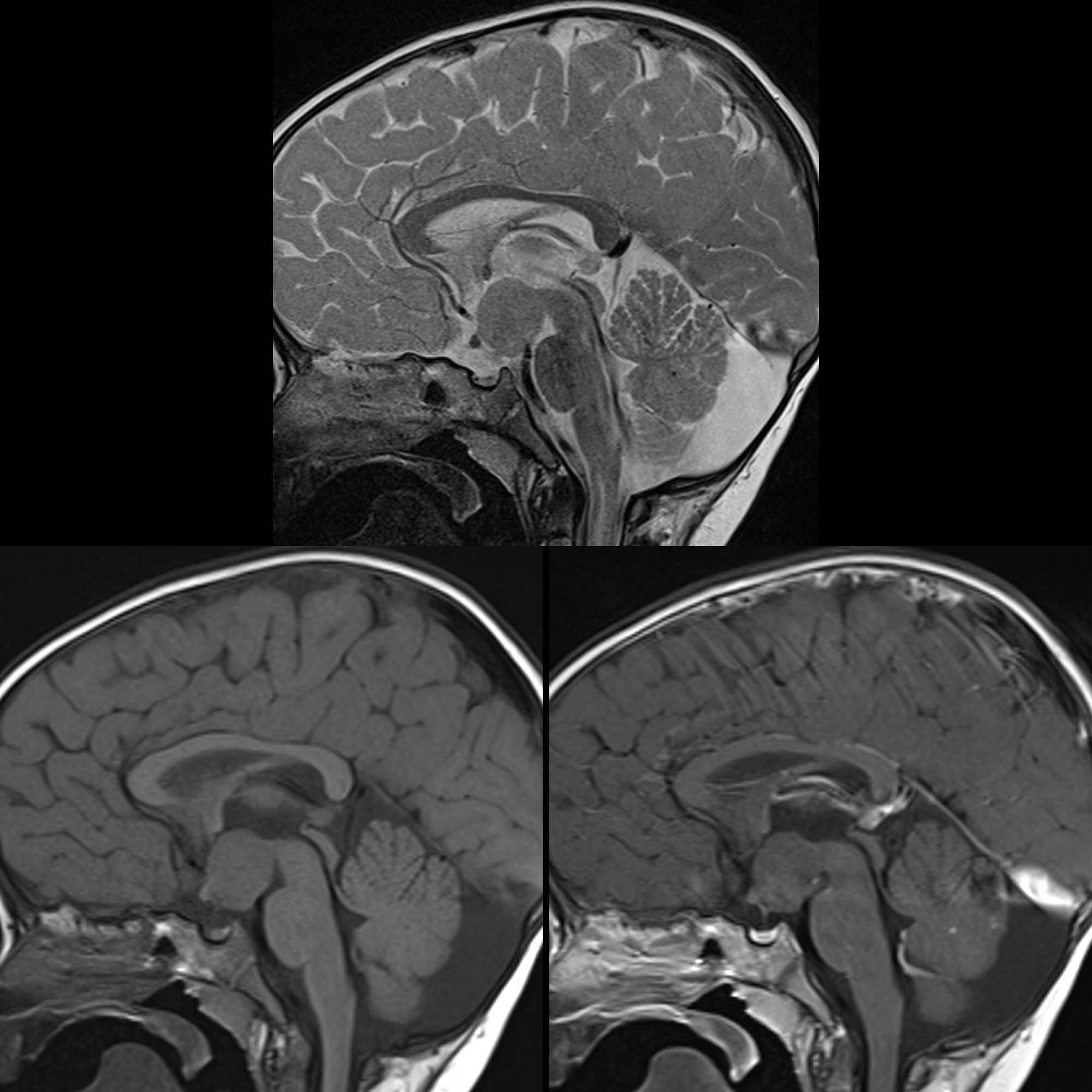 Toddler with a genetic syndrome undergoing screening neuroimaging ...
