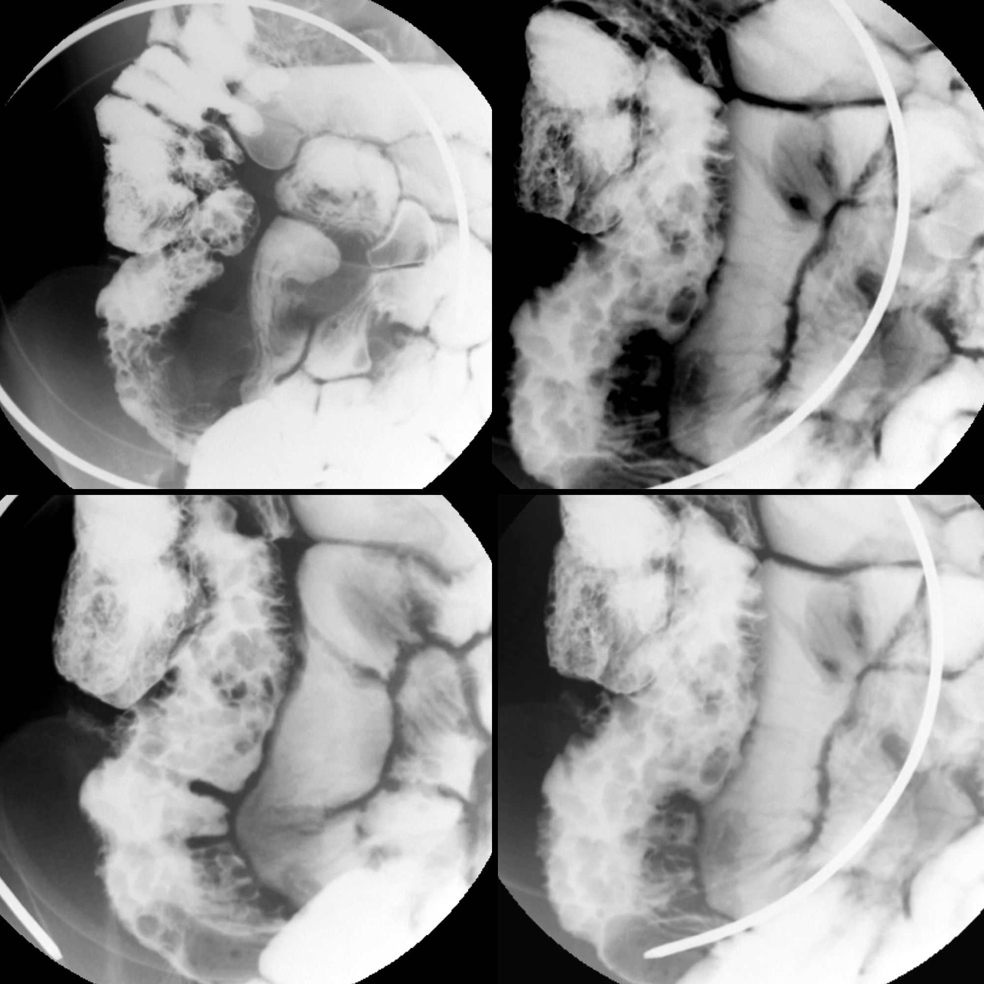 Pediatric Lymphoid Hyperplasia | Pediatric Radiology Reference Article ...