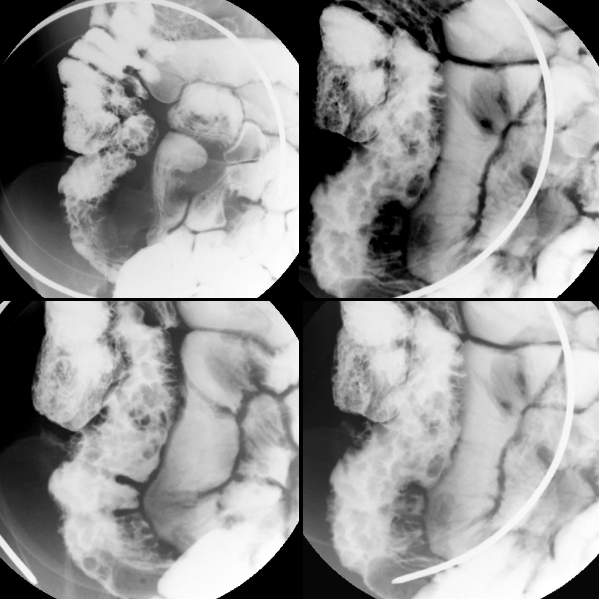 School ager with intermittent abdominal pain | Pediatric Radiology Case ...