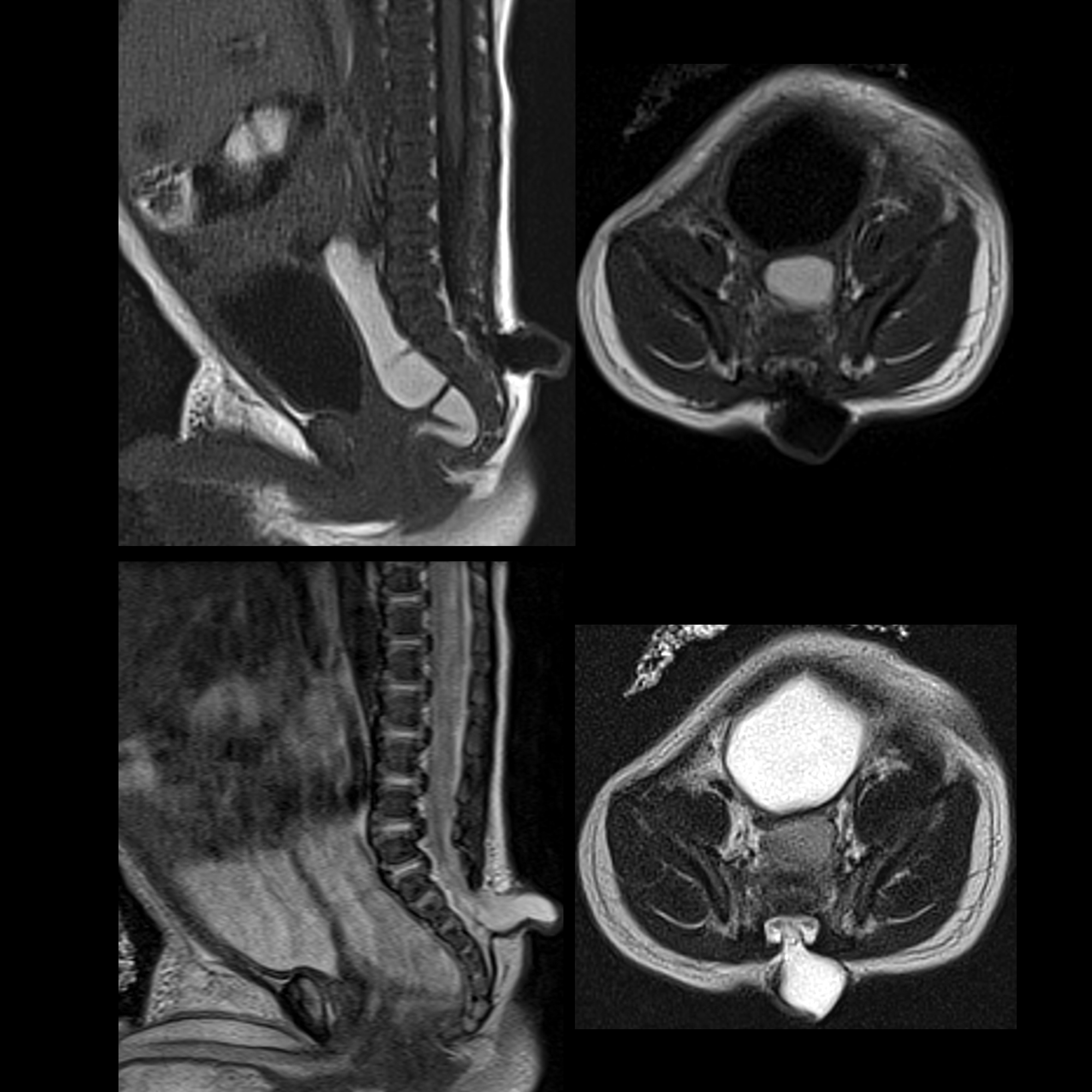 Meningocele | Pediatric Radiology Reference Article | Pediatric Imaging ...