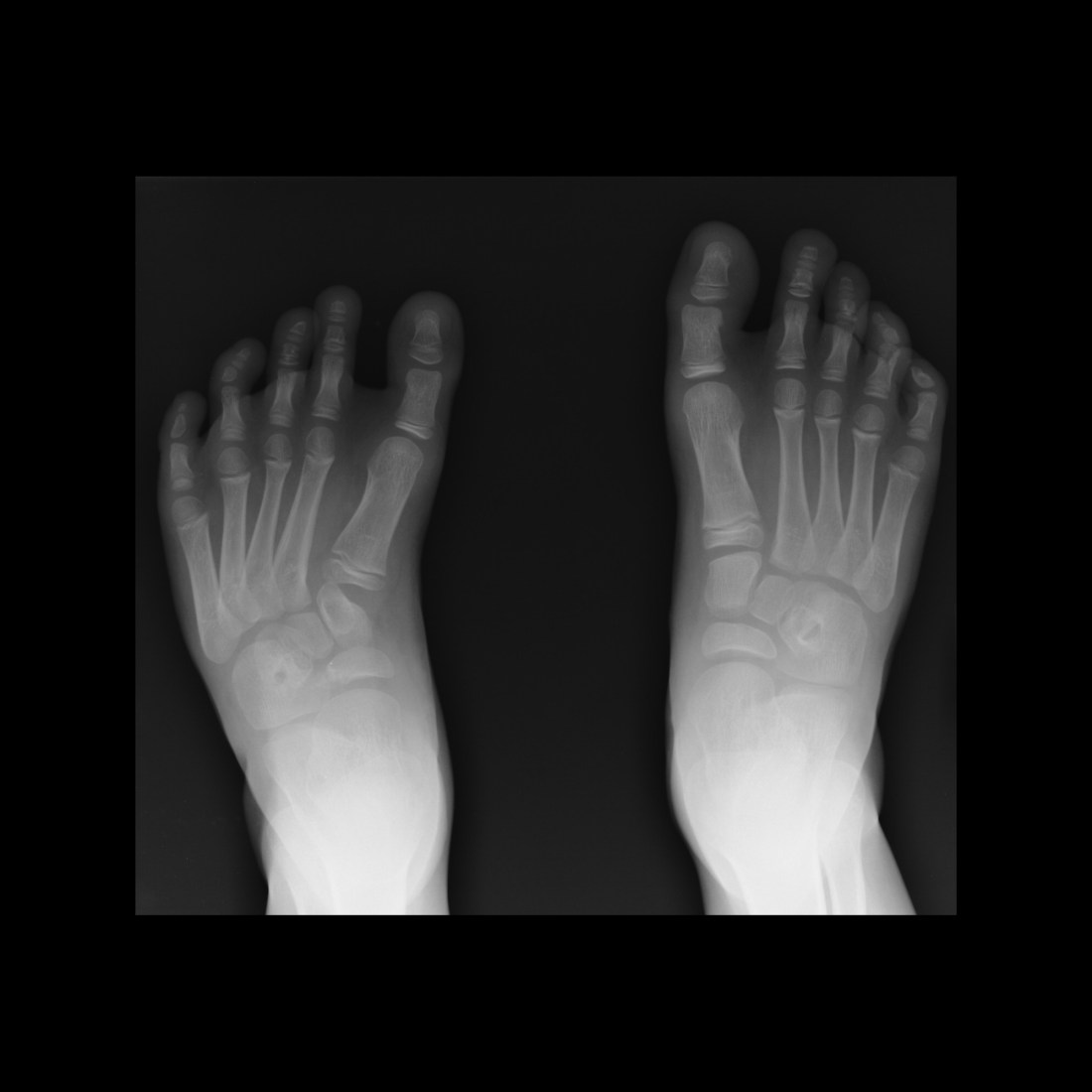 Clubfoot | Pediatric Radiology Reference Article | Pediatric Imaging ...