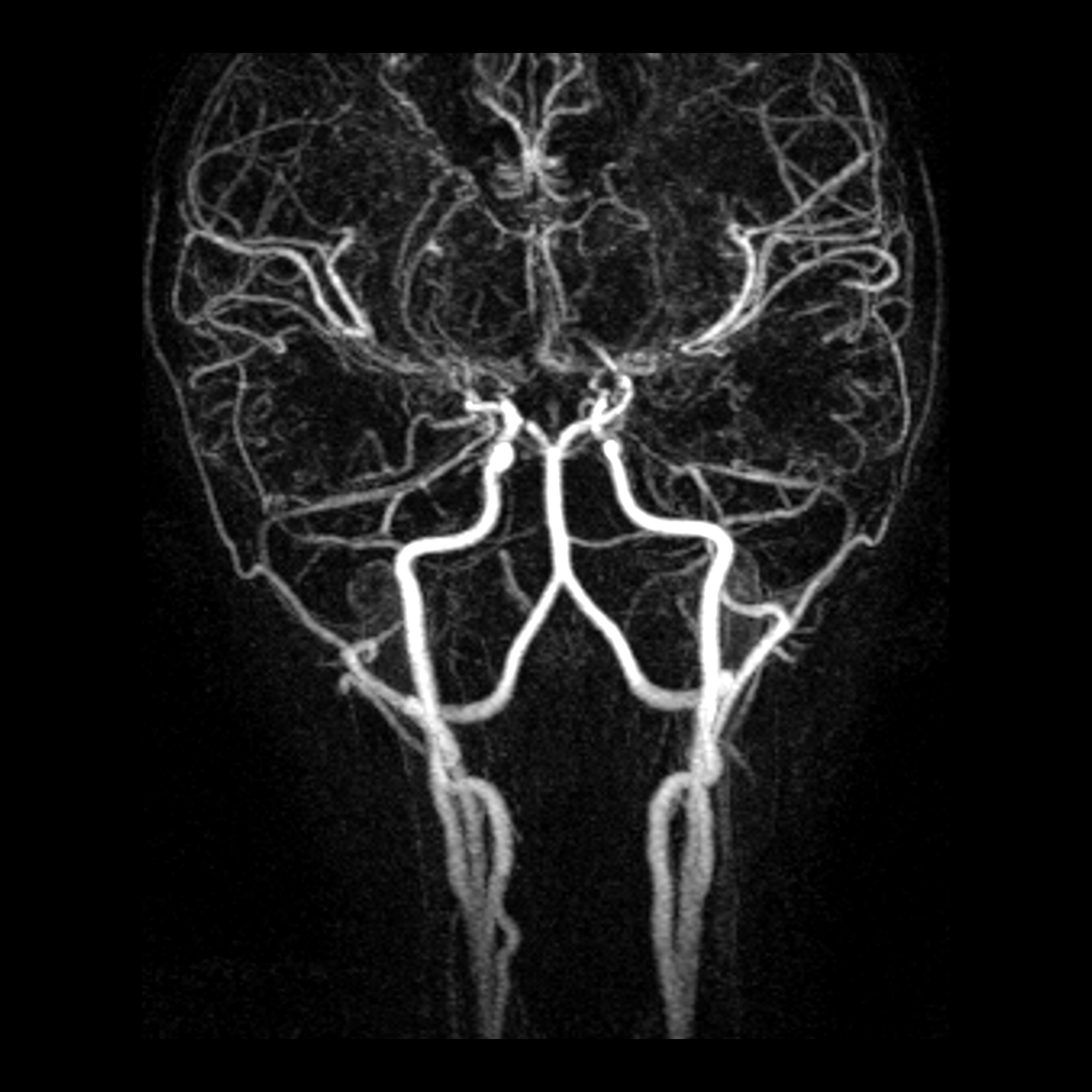 Pediatric Moya Moya Disease | Pediatric Radiology Reference Article ...